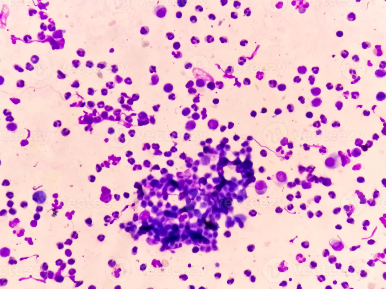 Synovial Fluid Cytology Plenty Wbc Microscopic Examination Of Synovial Fluid To Diagnose