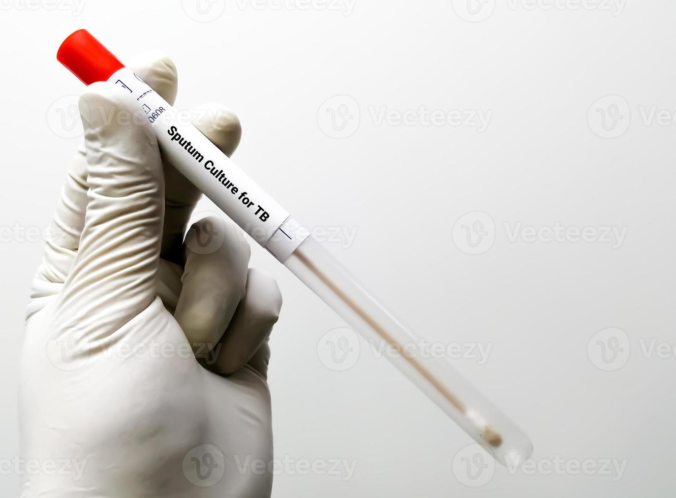 Sputum Culture Test For The Diagnosis Of Tuberculosis Or Tb 20450305