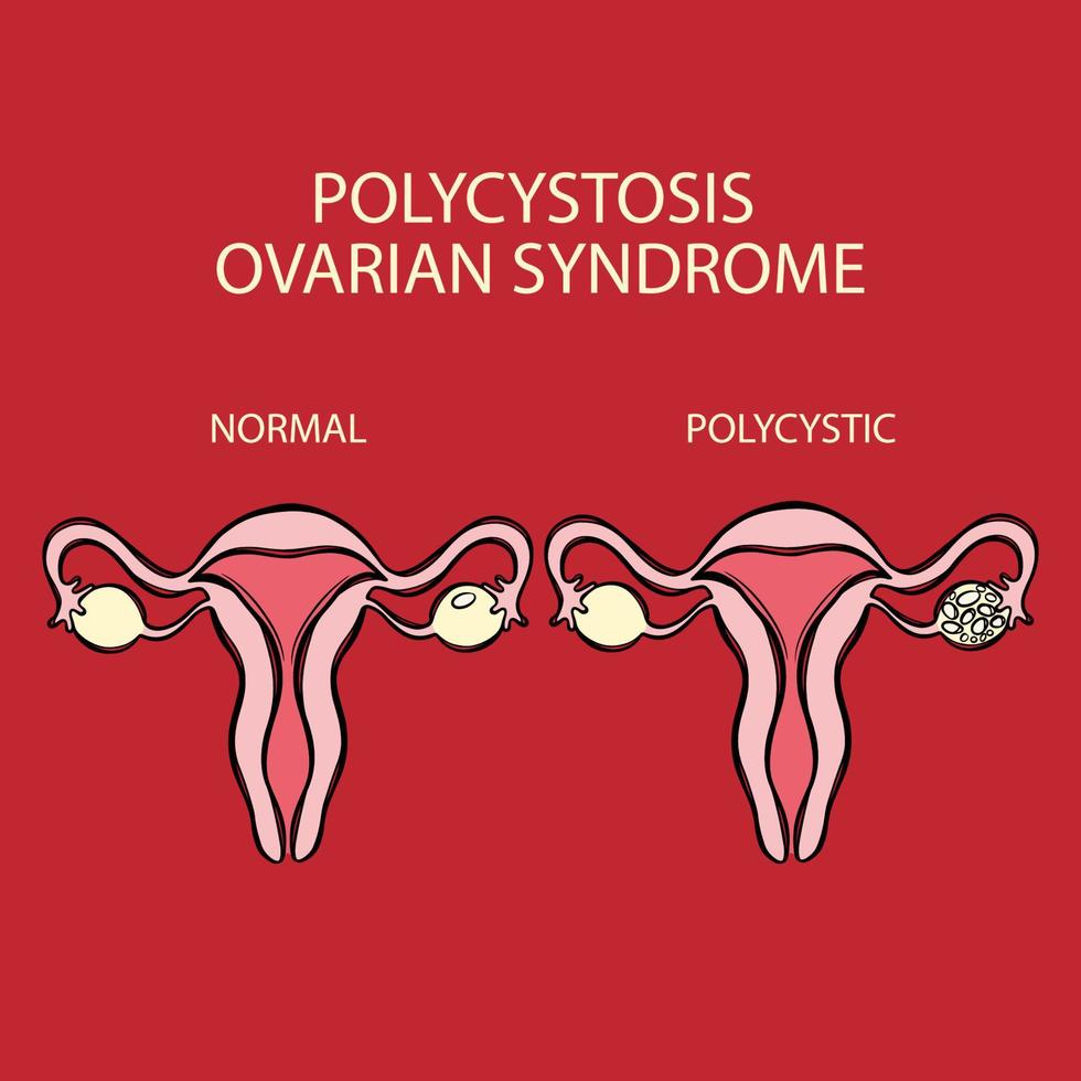 Polycystic Ovarian Syndrome Vs Normal Reproductive System 20454634