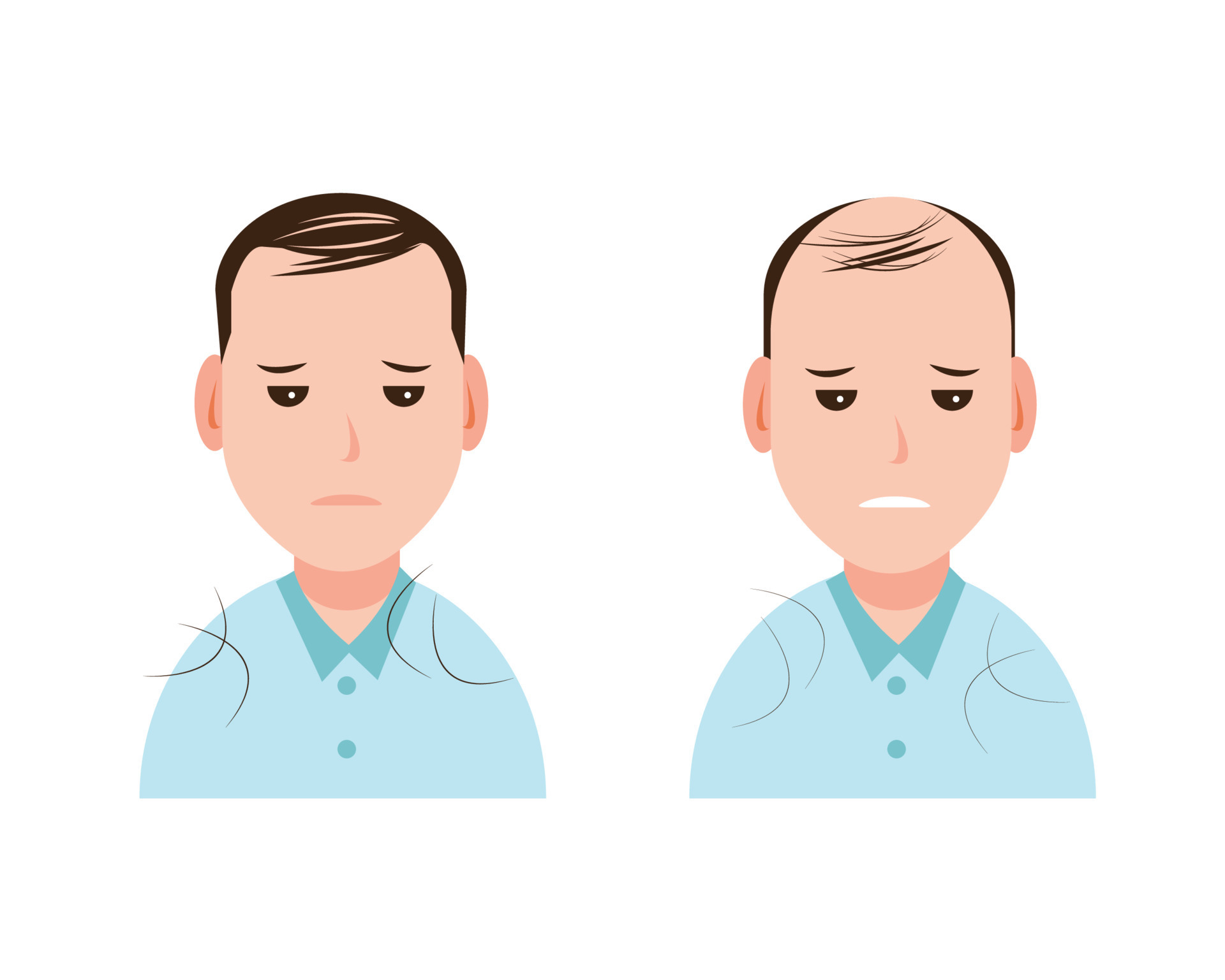 Male Pattern Baldness Alopecia Type Of Hair Loss In Men Vector