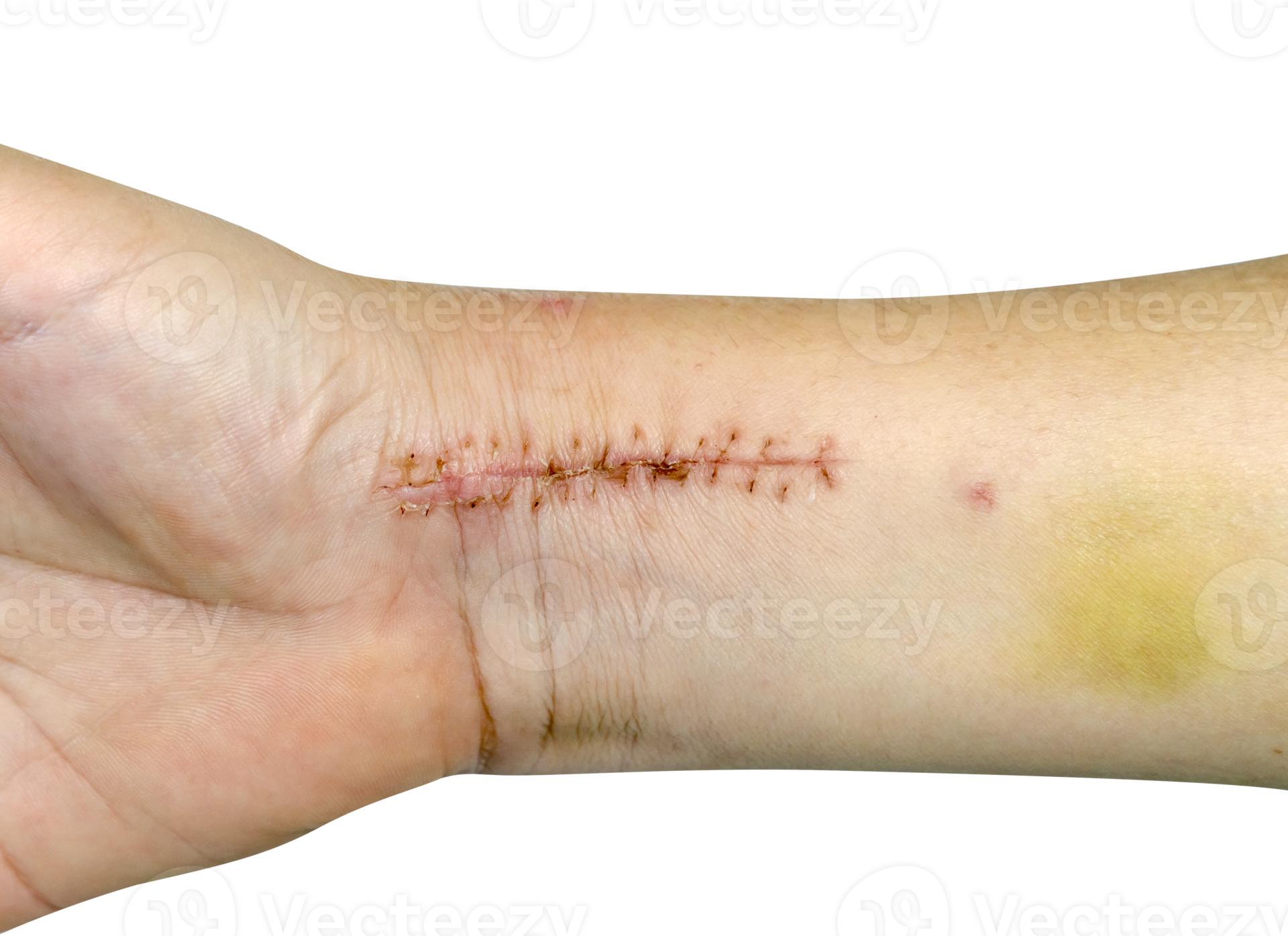 closeup stitches from broken arm surgery and bruised isolated 22786593 PNG