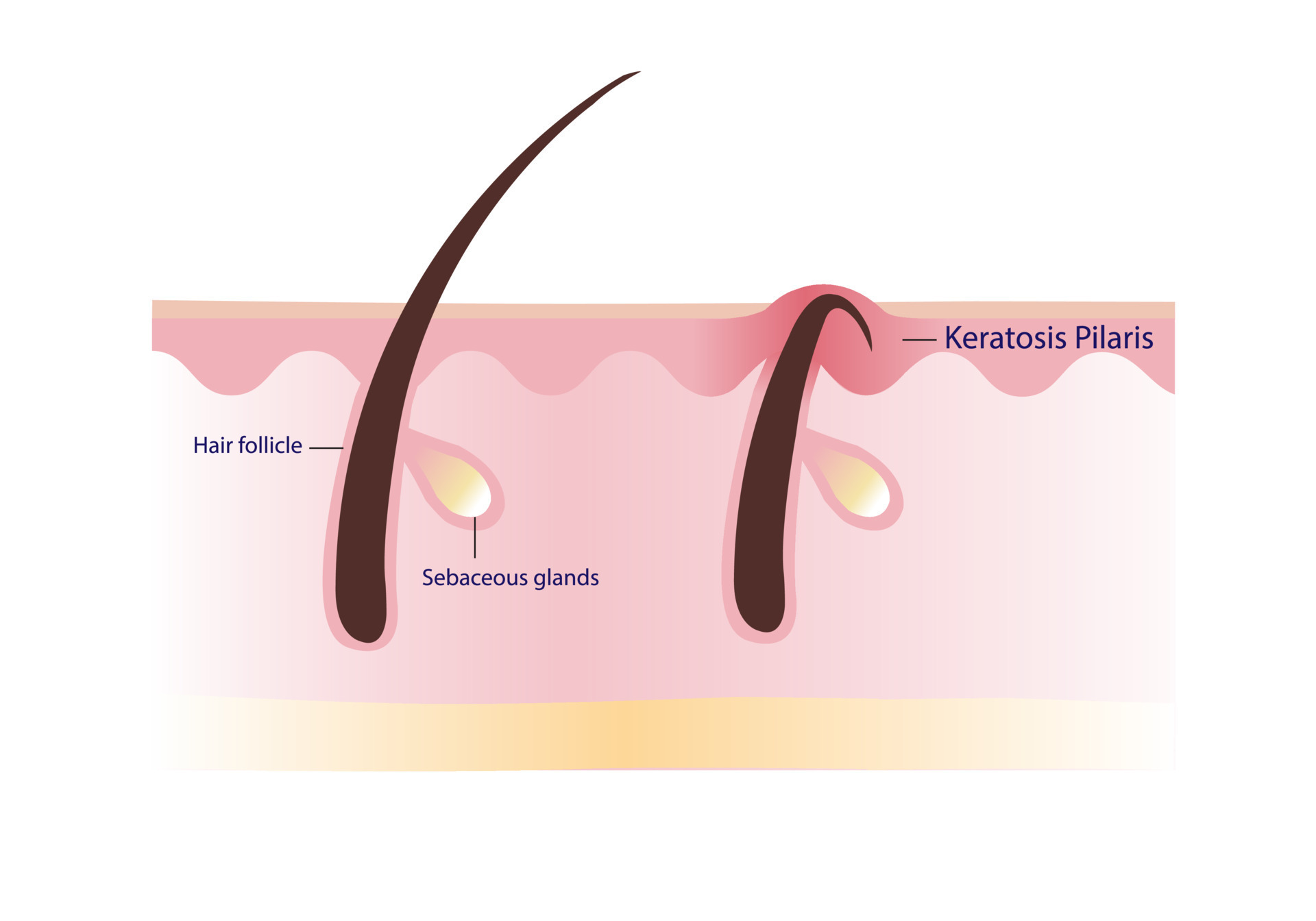 Keratosis Pilaris Chicken Skin Vector Illustration On White Background