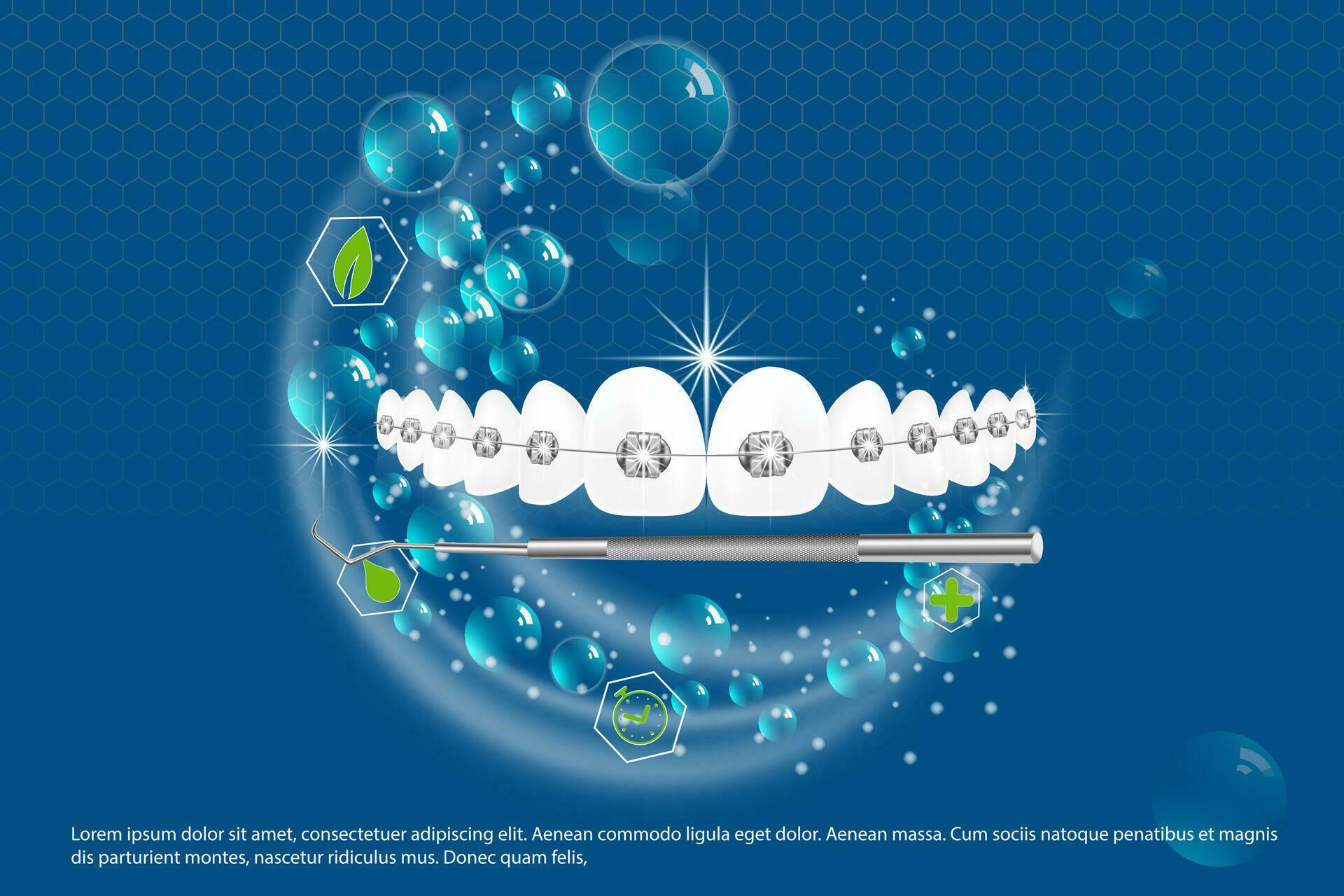 3d Vector Illustration Realistic Teeth With Braces Alignment Of The