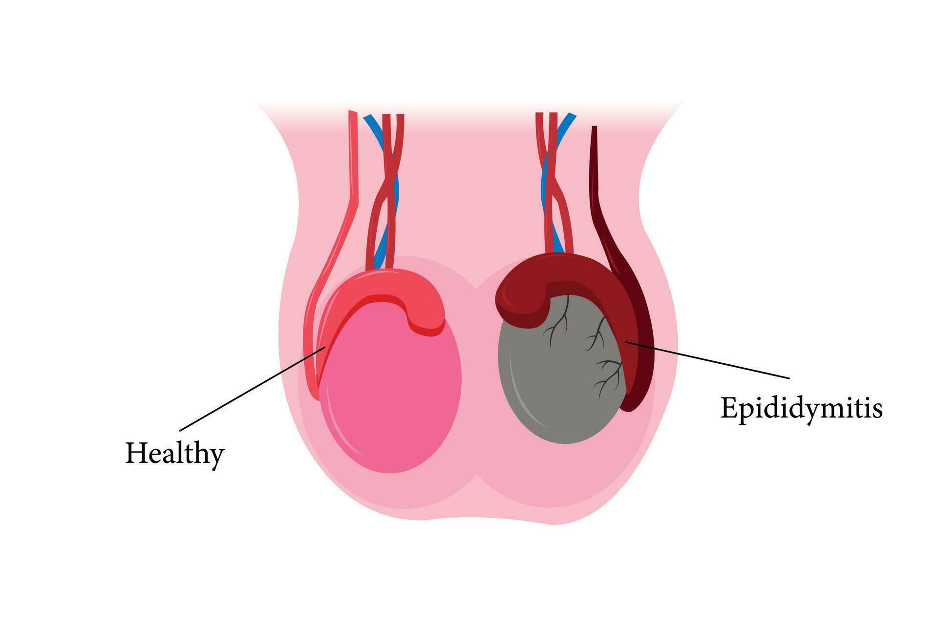 Illustration Of Epididimitis Inflamasi Epididimis Epididymitis Is