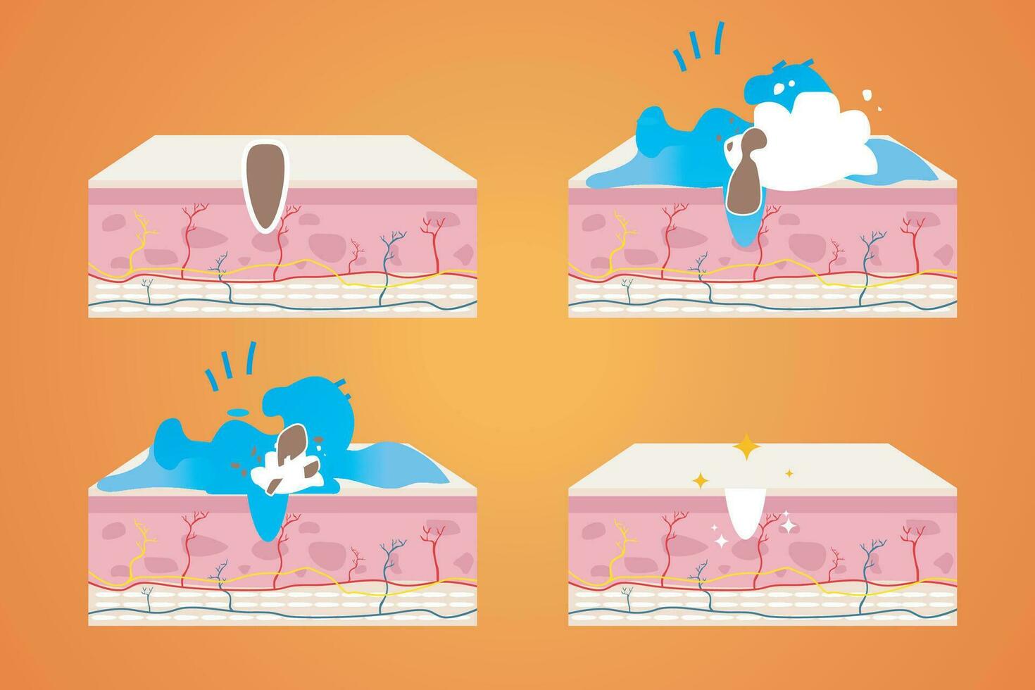 Cleaning blackheads process flat illustration. Clogged pores removal ... Cleaning blackheads process flat illustration. Clogged pores removal ...