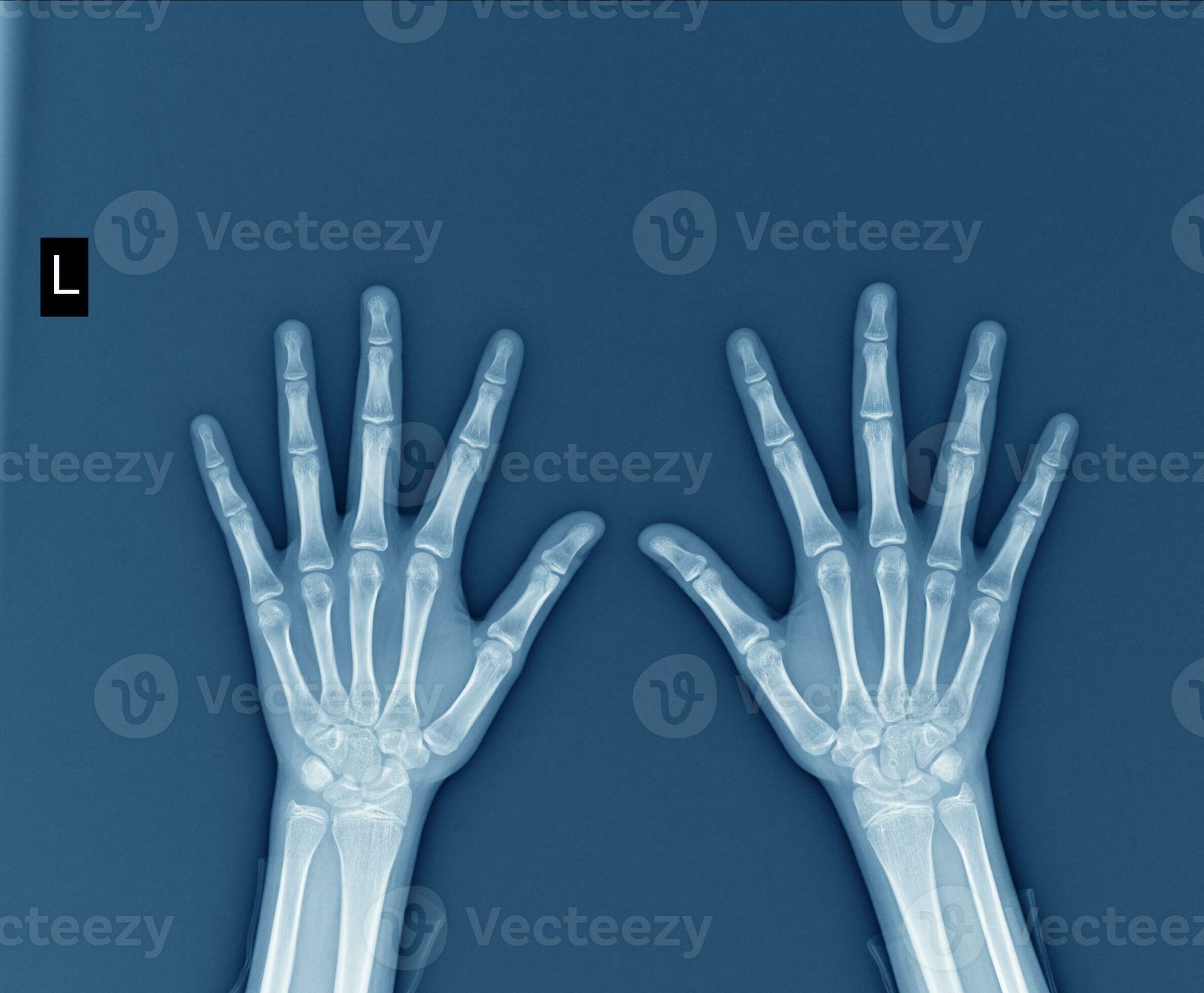 x-ray both hands on white background Medical image concept. 26434043 ...