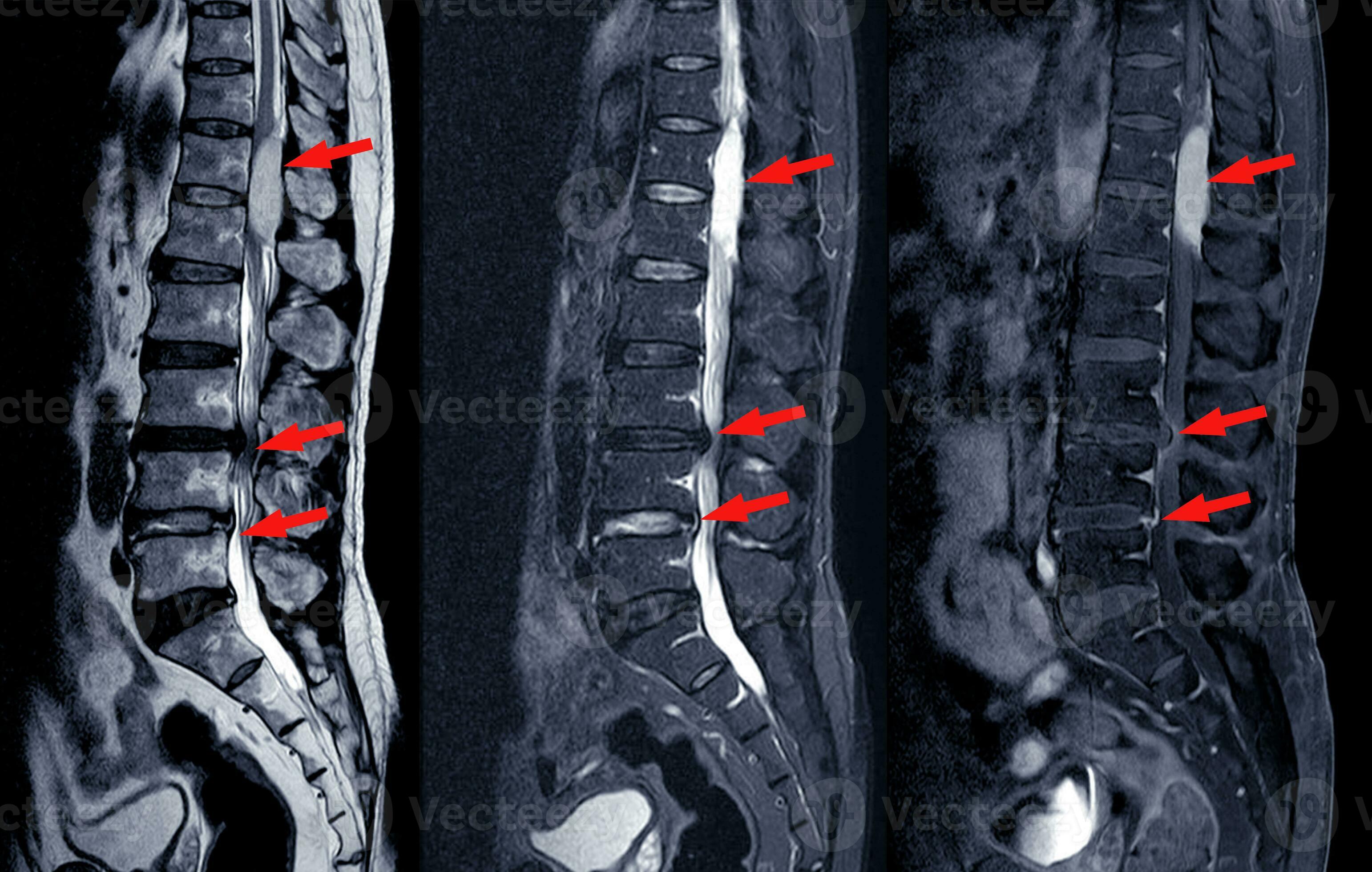 MRI scan of lumbar spines of a patient finding Spinal mass at Lt.side T12-L1 level Severe ...