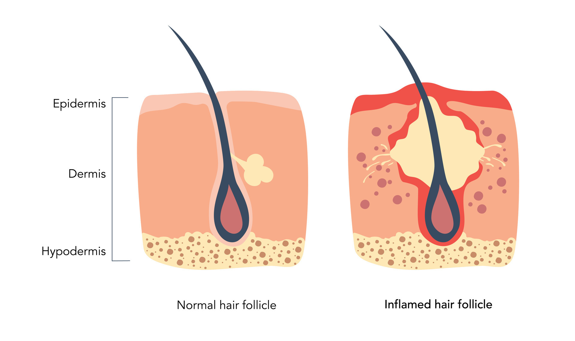 Infected Hair Shaft