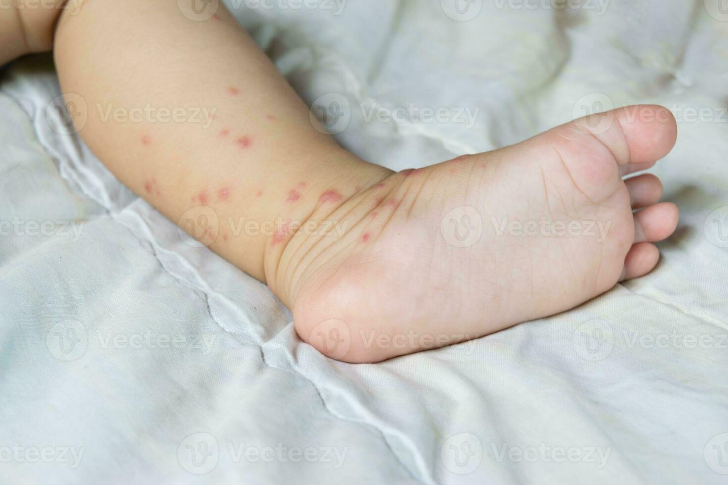 Red rash caused by foot-and-mouth infection in infant legs 27806473 ... Red rash caused by foot-and-mouth infection in infant legs 27806473 ...