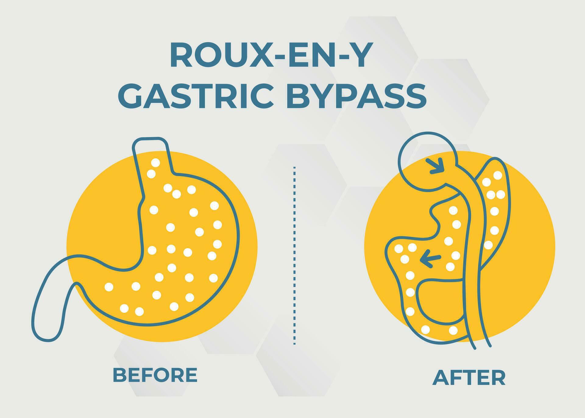 Gastric Bypass RNY Weight Loss Surgery vector illustration icon Roux-en-Y 29023525 Vector Art at ...