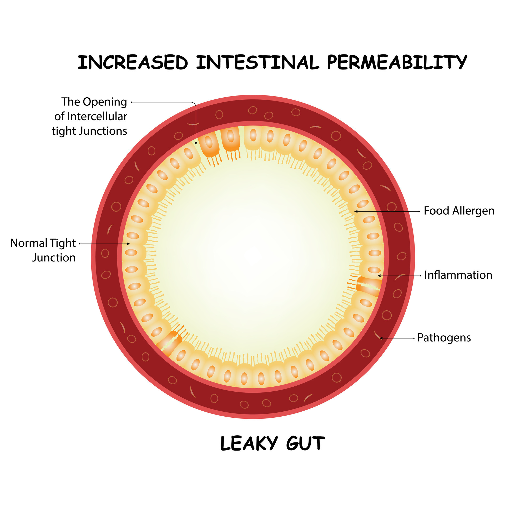 Increased Intestinal Permeability Design Vector Illustration 30339986