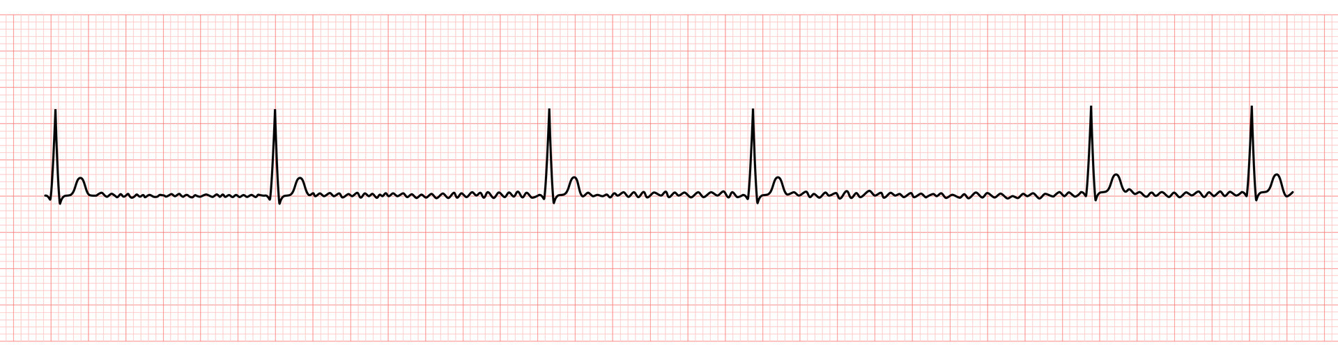 EKG Monitor Showing Atrial Fibrillation With Slow Ventricular Response ... EKG Monitor Showing Atrial Fibrillation With Slow Ventricular Response ...