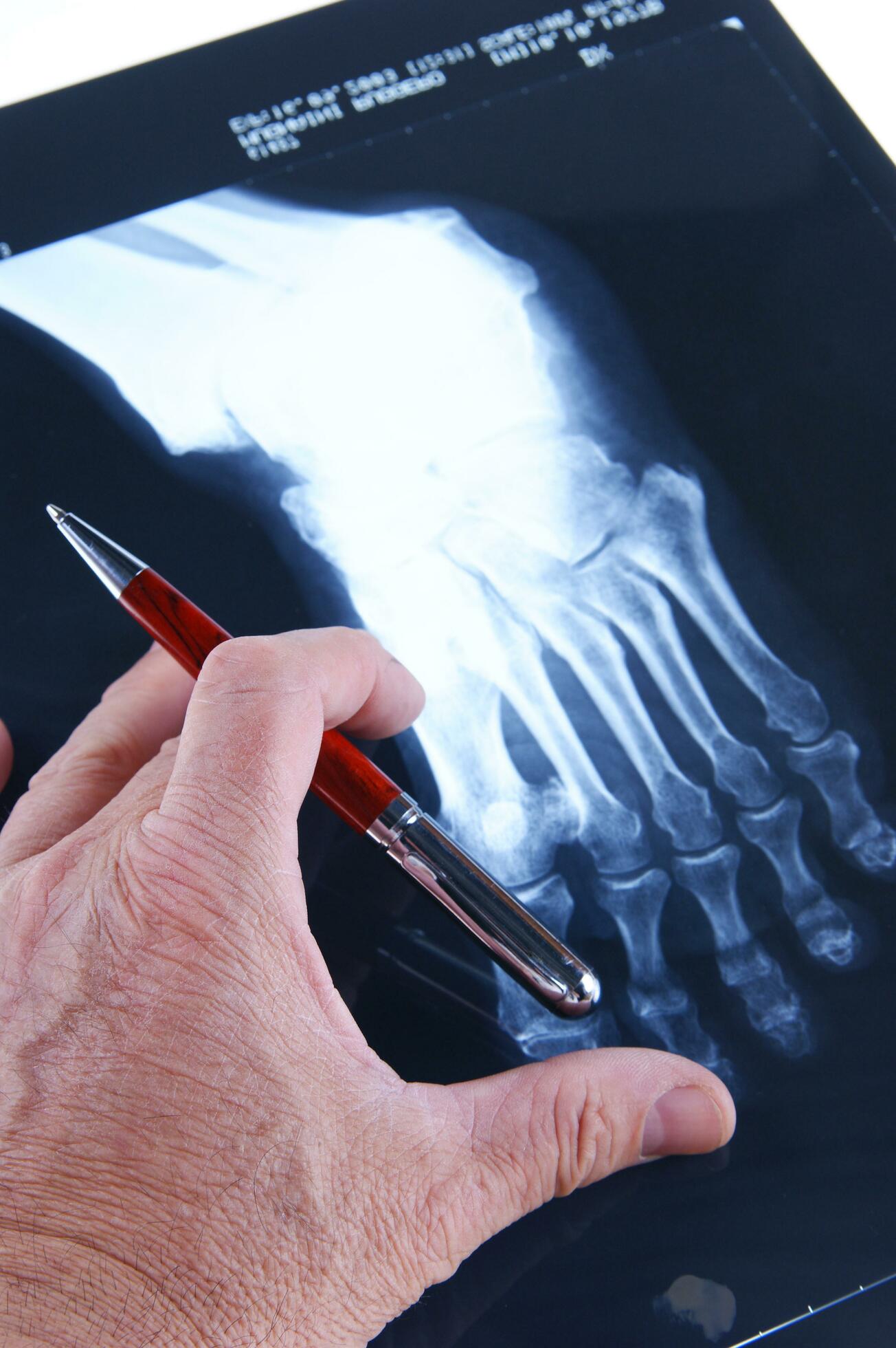 two x - rays of the hand showing the fingers 30746838 Stock Photo at ...