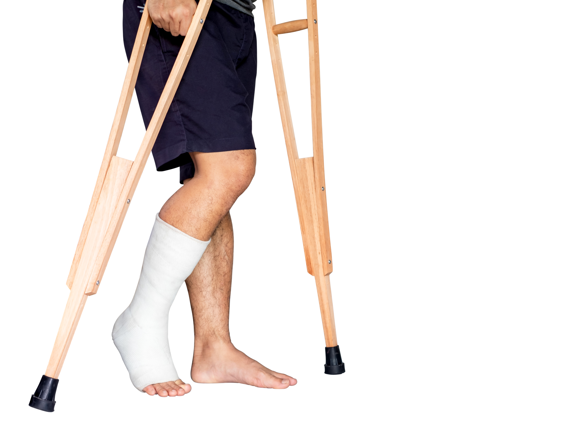 Close Up Patient With Broken Leg In Cast And Bandage Man With Leg Splint Is Walking Support