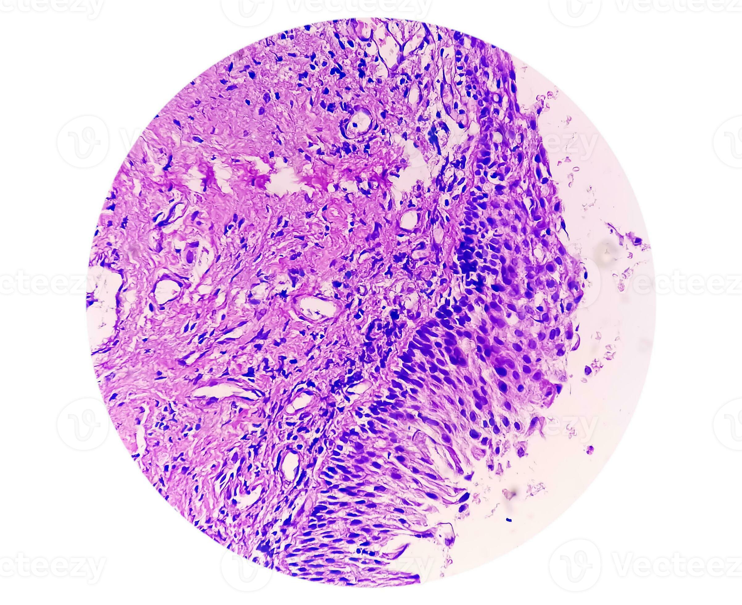 Histology Of Urachal Cyst Photomicrograph Of Histological Stained