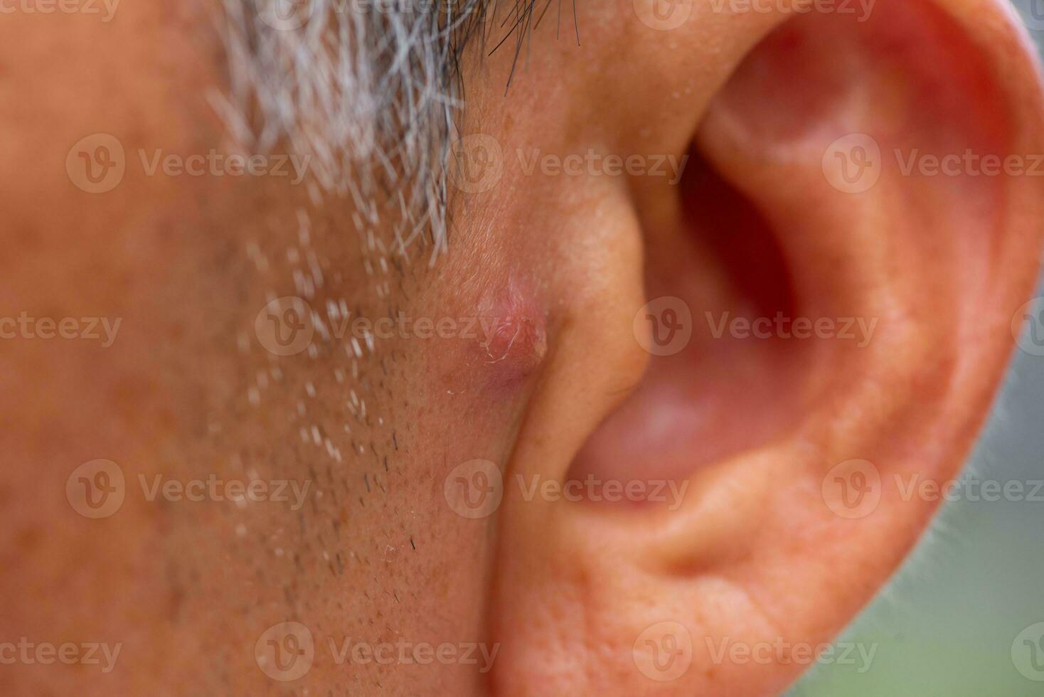 Sebaceous Cyst Stock Photos Images And Backgrounds For Free Download sebaceous-cyst-stock-photos-images-and-backgrounds-for-free-download