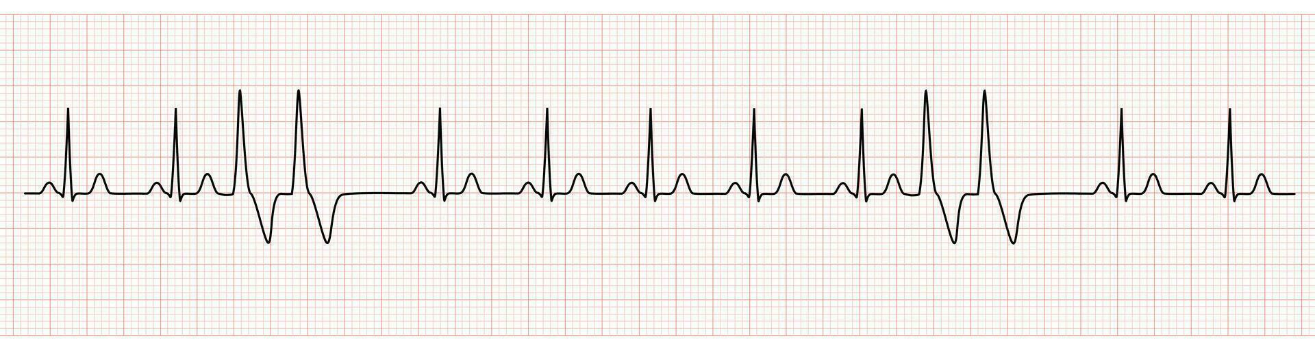 Ekg Monitor Showing Sinus Rhythm With Couplets Pvc 35372508 Vector Art At Vecteezy