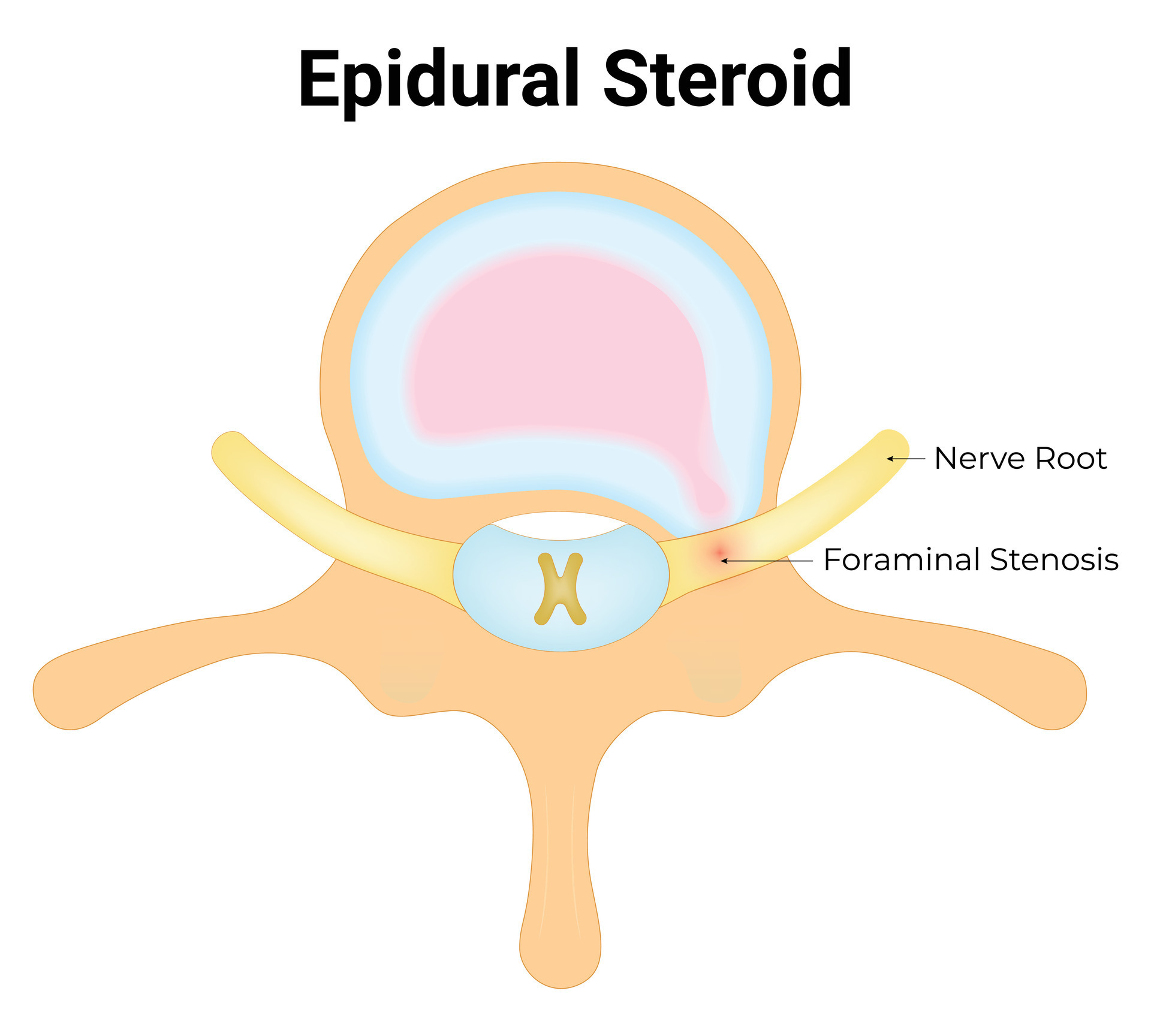 Epidural Steroid Science Design Vector Illustration Diagram 38010596
