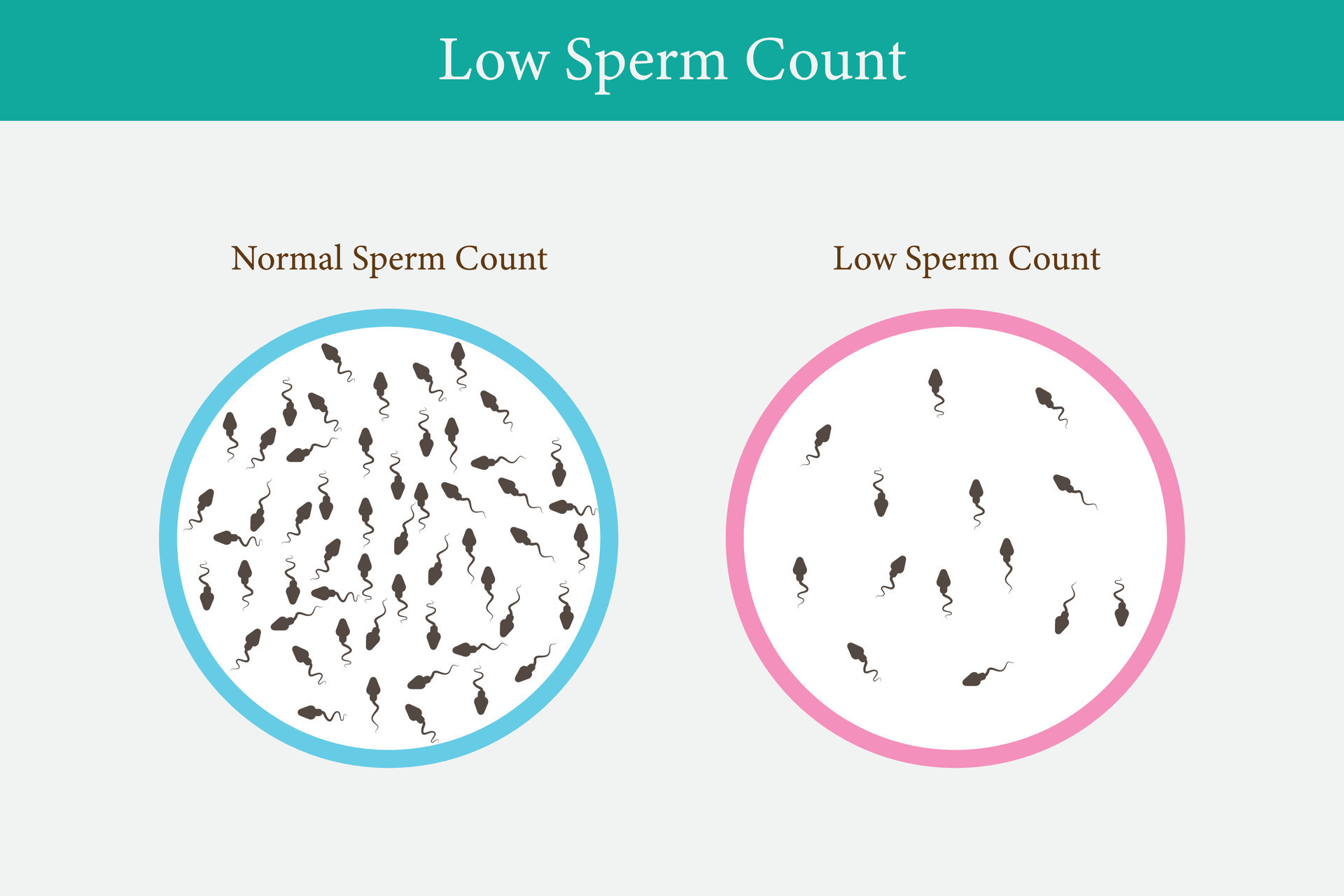 Normal And Low Sperm Count Illustration Male Infertility Oligospermia Structure Of The Sperm