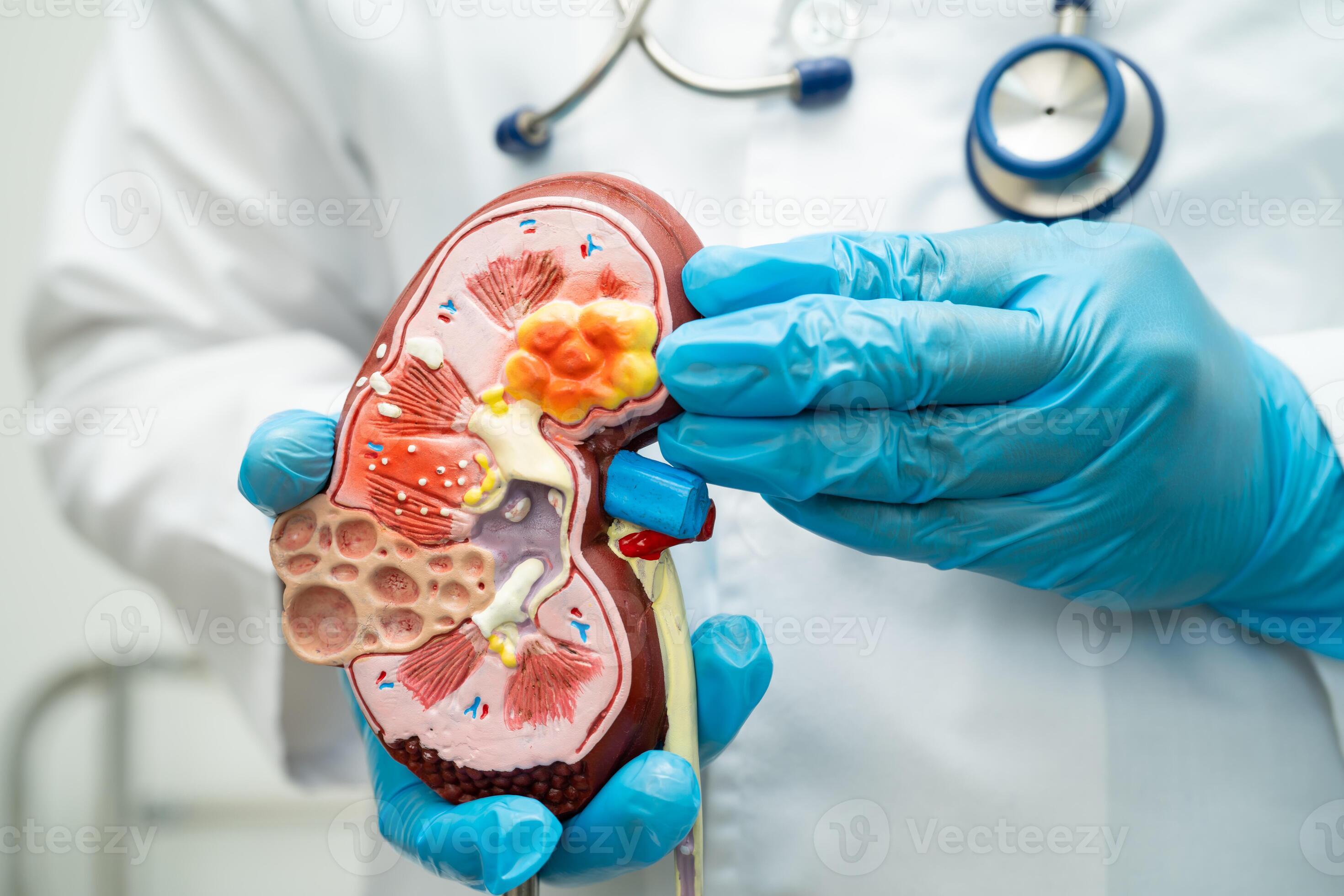 riñón enfermedad, crónico riñón enfermedad ckd, médico con humano modelo a estudiar y tratar en ...