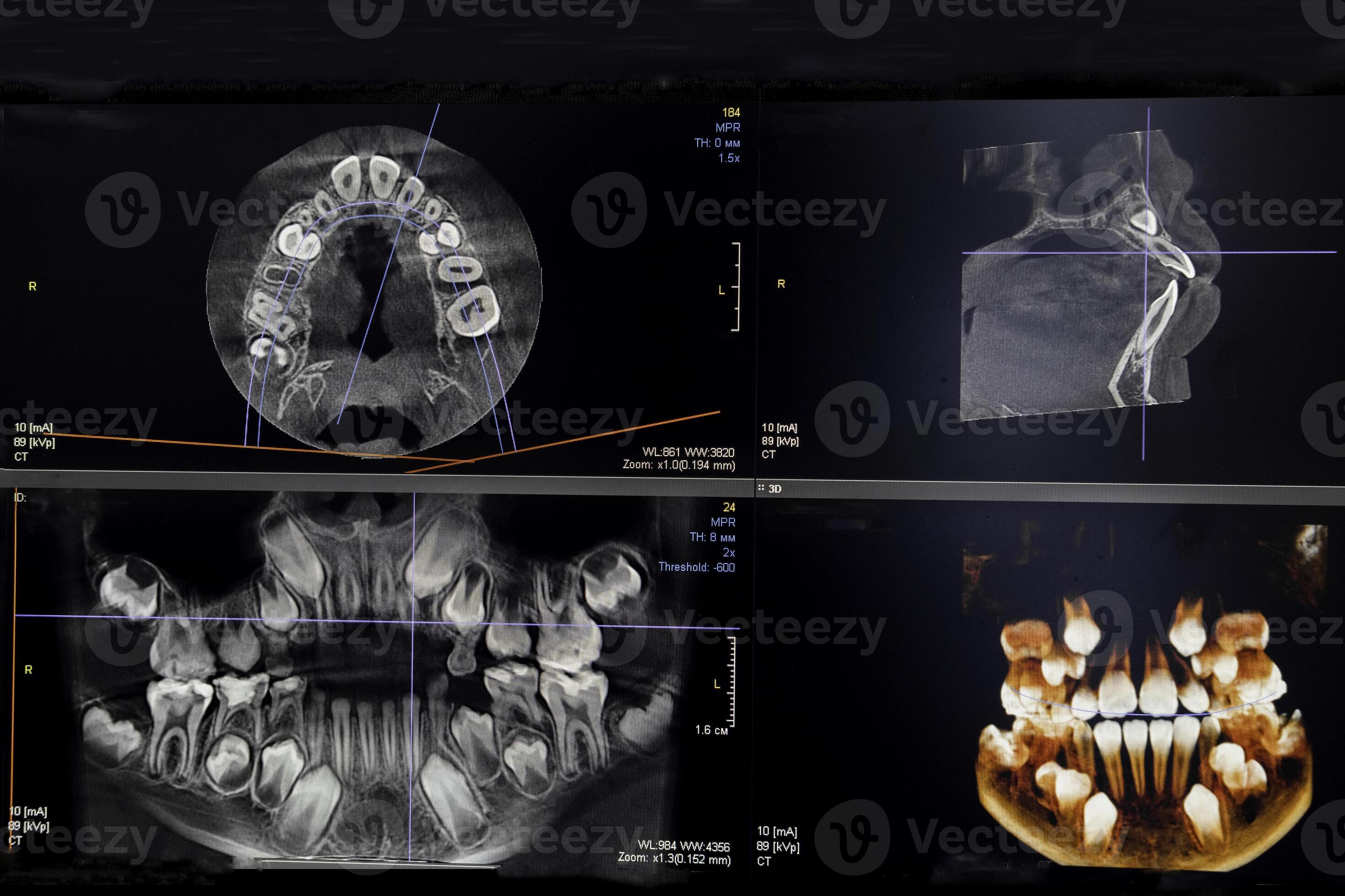 CT image of the teeth of a 9-year-old child, with baby teeth, in different projections. CBCT of ...