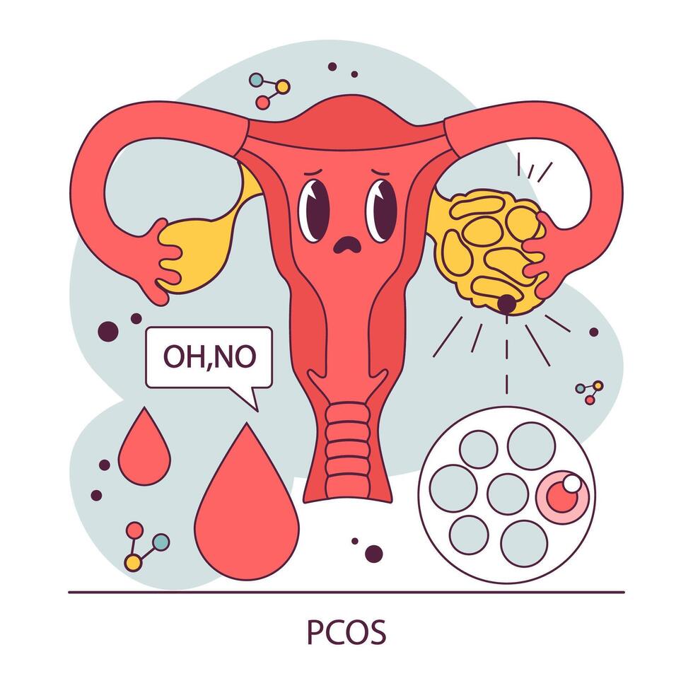Pcos Polycystic Ovary Syndrome Female Reproductive System Endocrine
