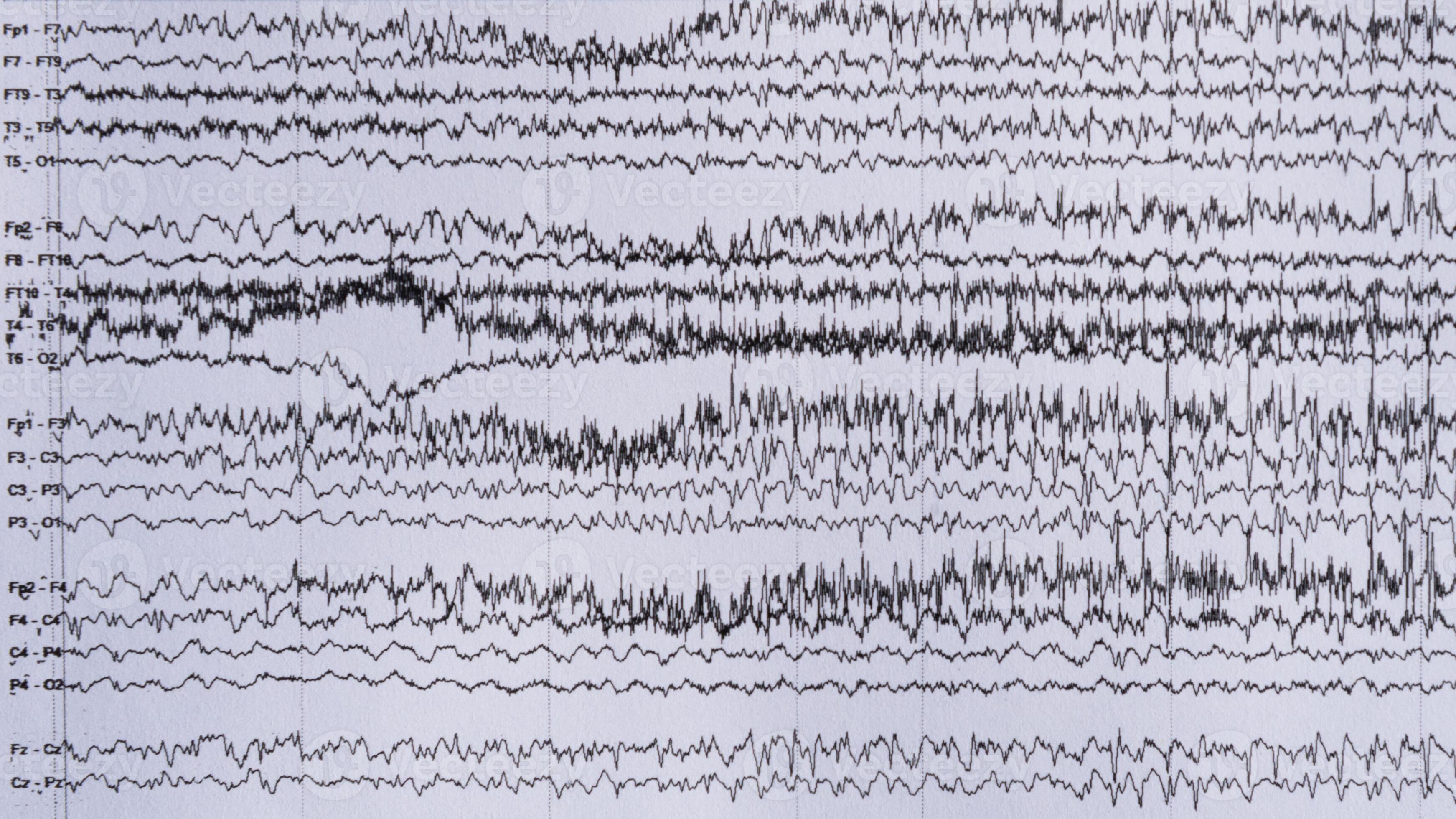 Imaging of ictal EEG recording in epilepsy patient 42230768 Stock Photo ... Imaging of ictal EEG recording in epilepsy patient 42230768 Stock Photo ...