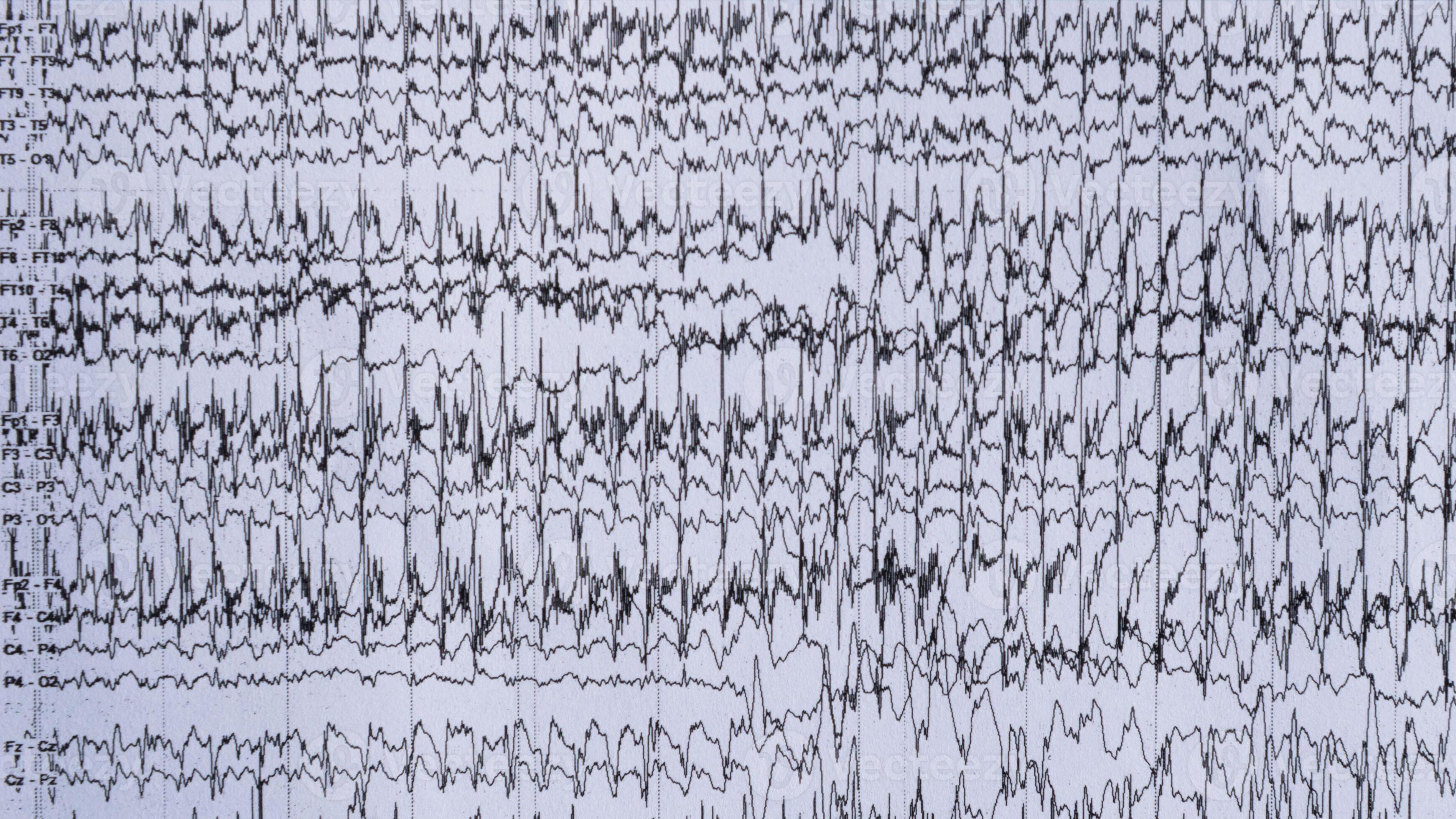 Imaging of ictal EEG recording in epilepsy patient 42230769 Stock Photo ... Imaging of ictal EEG recording in epilepsy patient 42230769 Stock Photo ...