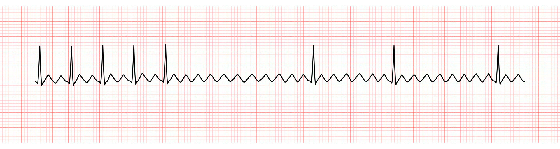 Ekg Monitor Showing Atrial Flutter With 2 To 1 Av Block After Adenosine Intravenous 42268618