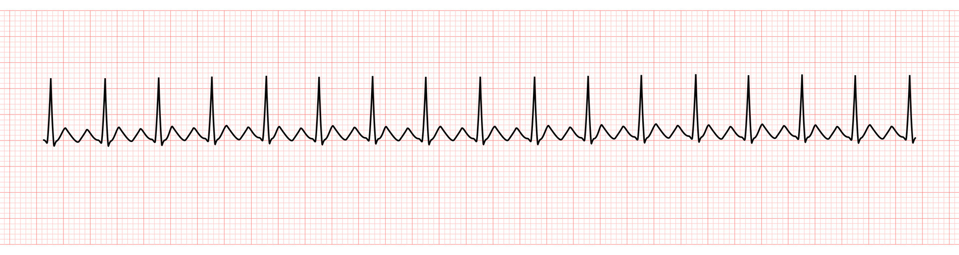Ekg Monitor Showing Atrial Flutter With 2 To 1 Av Block 42268620 Vector Art At Vecteezy