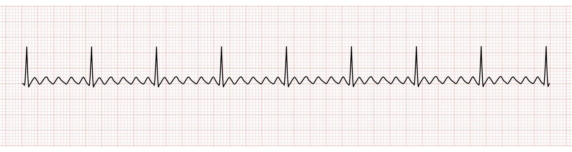 EKG Monitor Showing Atrial Flutter 42268648 Vector Art at Vecteezy
