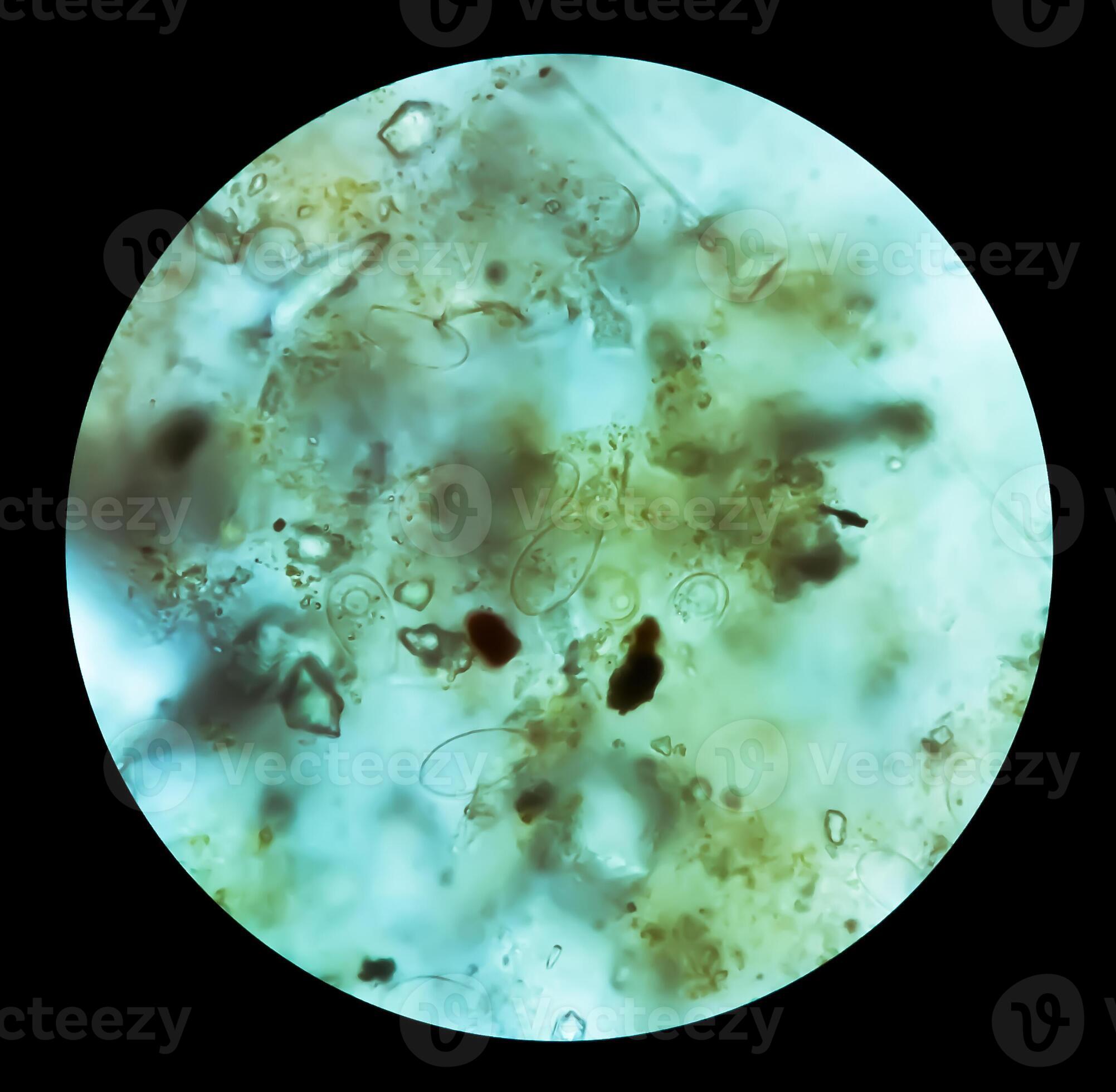 Schistosoma Parasite ova in human urine specimen under microscope. Urinary parasite 43292538 ...