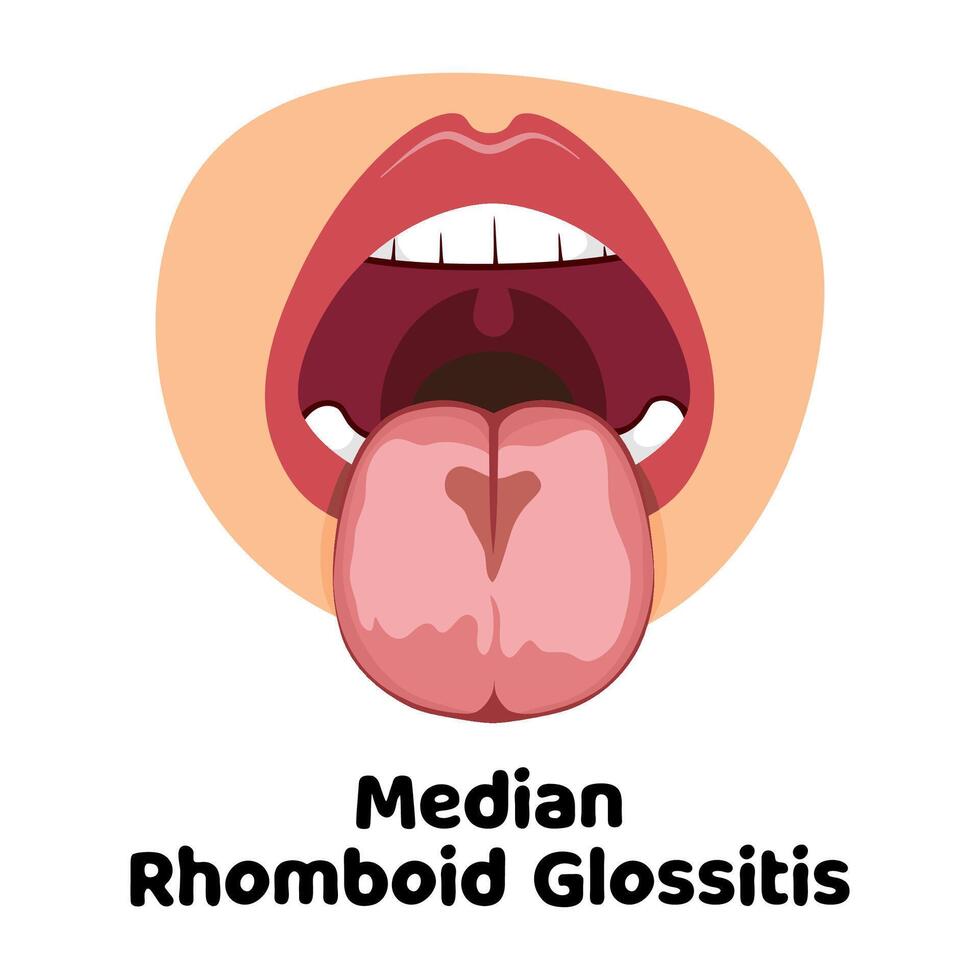 Median Rhomboid Glossitis Illustration 44569051 Vector Art At Vecteezy