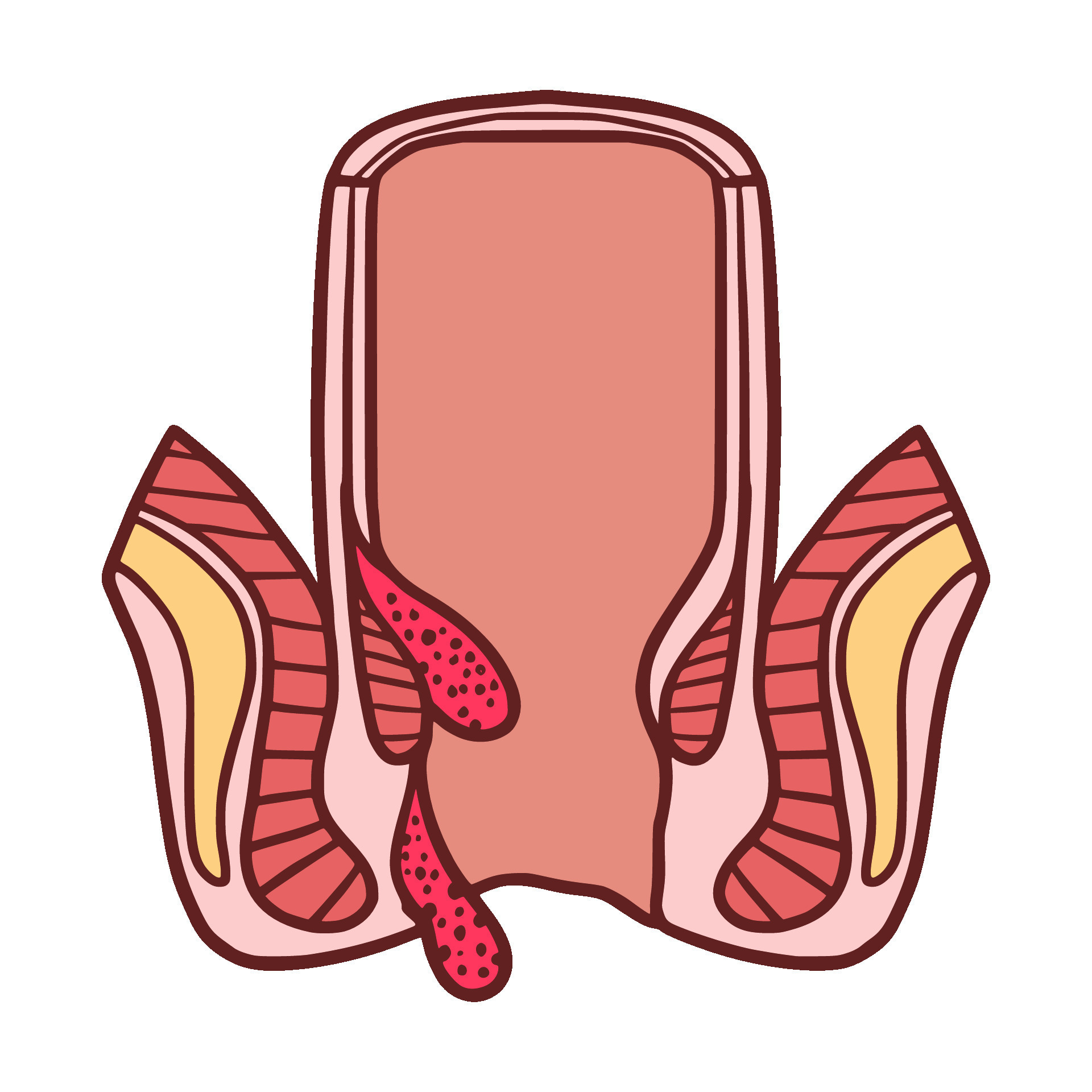 Internal And External Hemorrhoids Illustration 45481020 Vector Art At