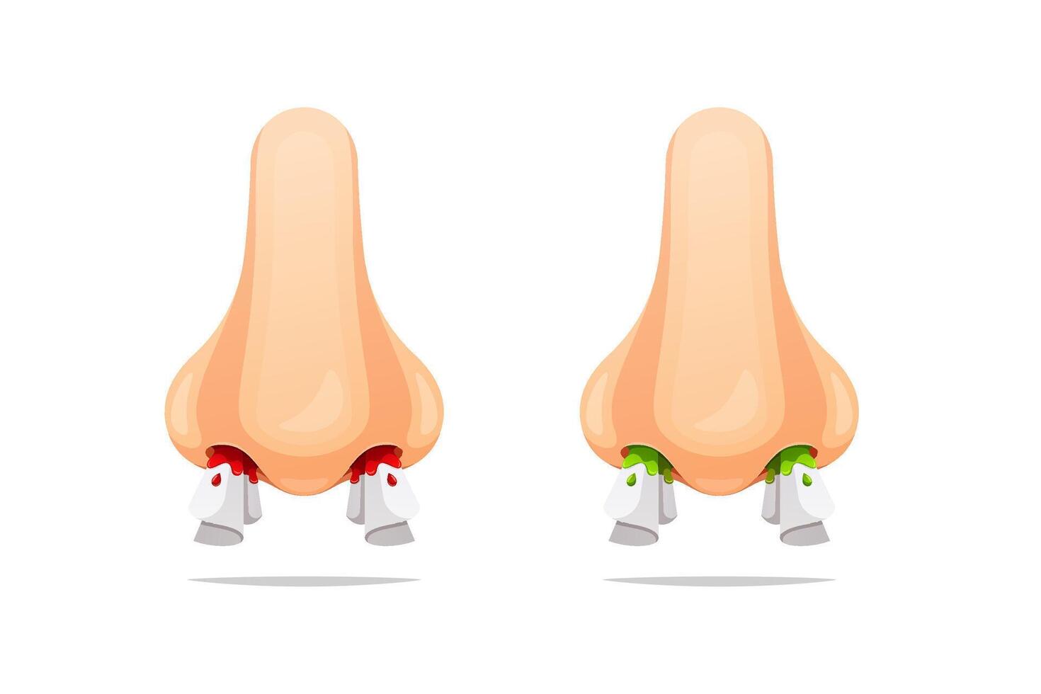 Nose Bleeds And Runny Nose With Tissue Isolated On White Background 45657458 Vector Art At Vecteezy