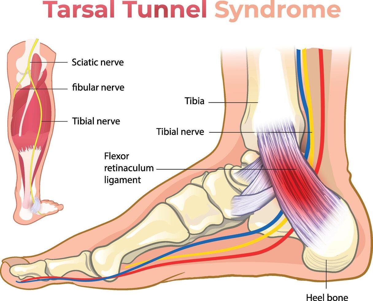 Illustration Of Tarsal Tunnel Syndrome Diagram 45993903 Vector Art At Vecteezy