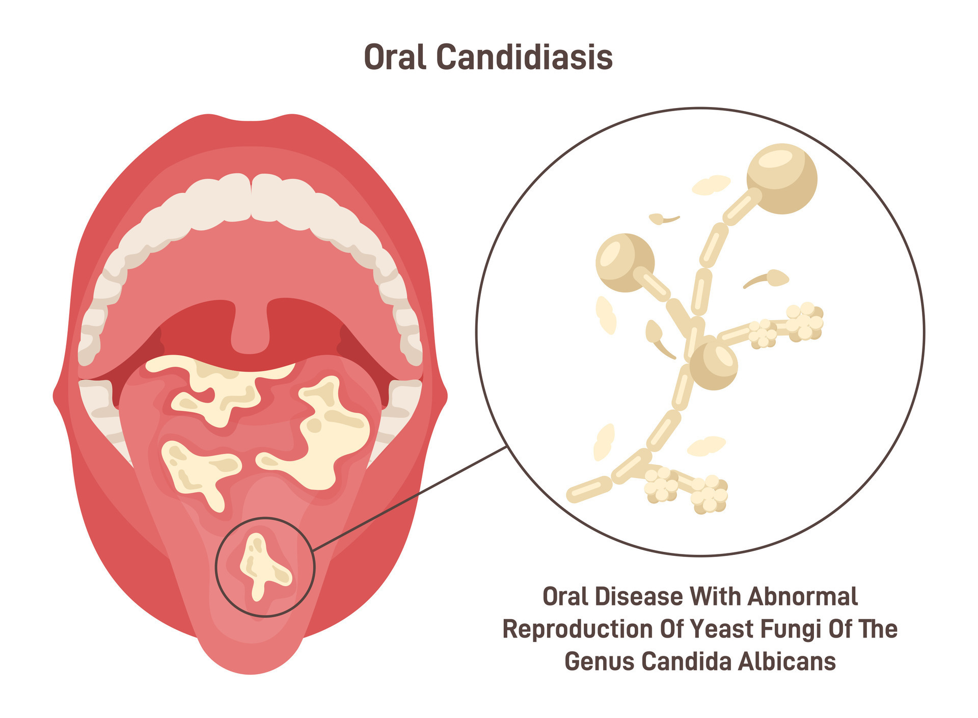 Oral Candidiasis Oral Yeast Infection Of Fungal Candida Albicans 46422848 Vector Art At Vecteezy