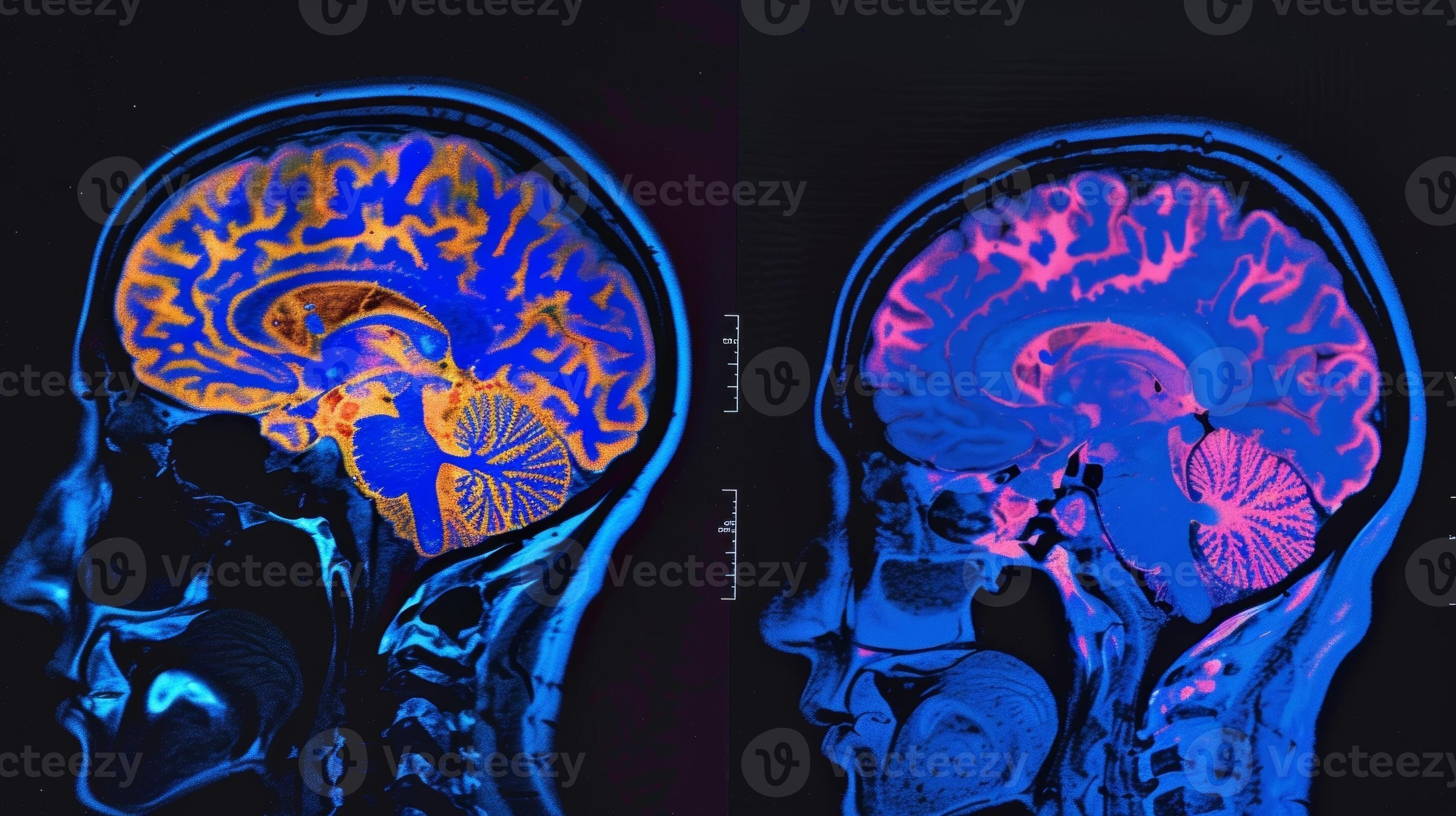 A before and after image of a brain scan showing the positive changes after attending CBT ...