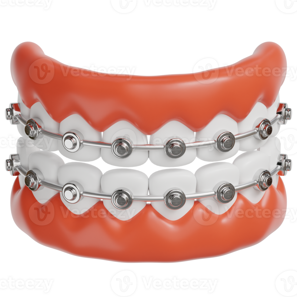 Braces 3d illustration 47246887 PNG