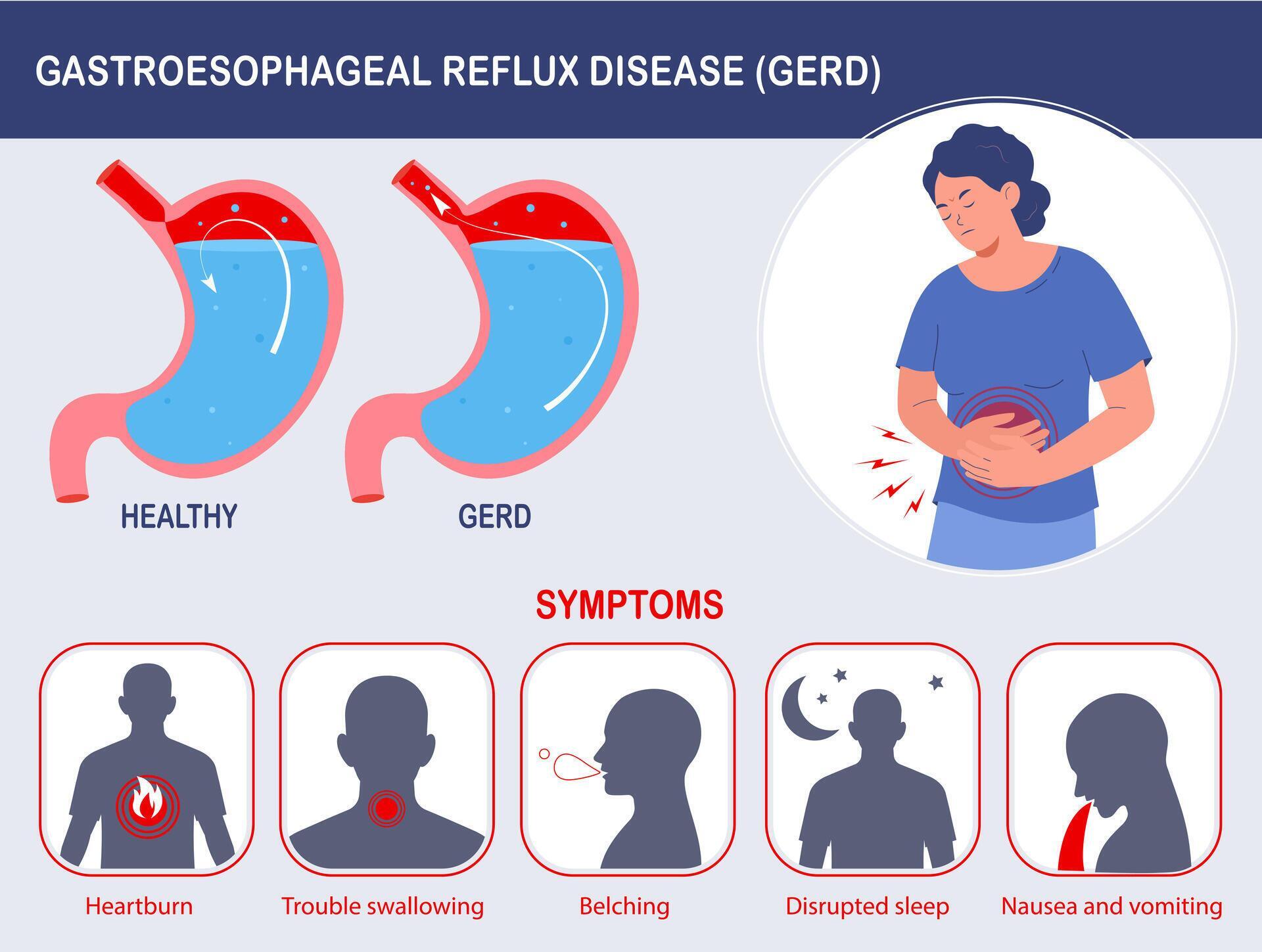 Gastroesophageal Reflux Disease GERD infographic. GERD symptoms. Medical info poster 47391166 ...