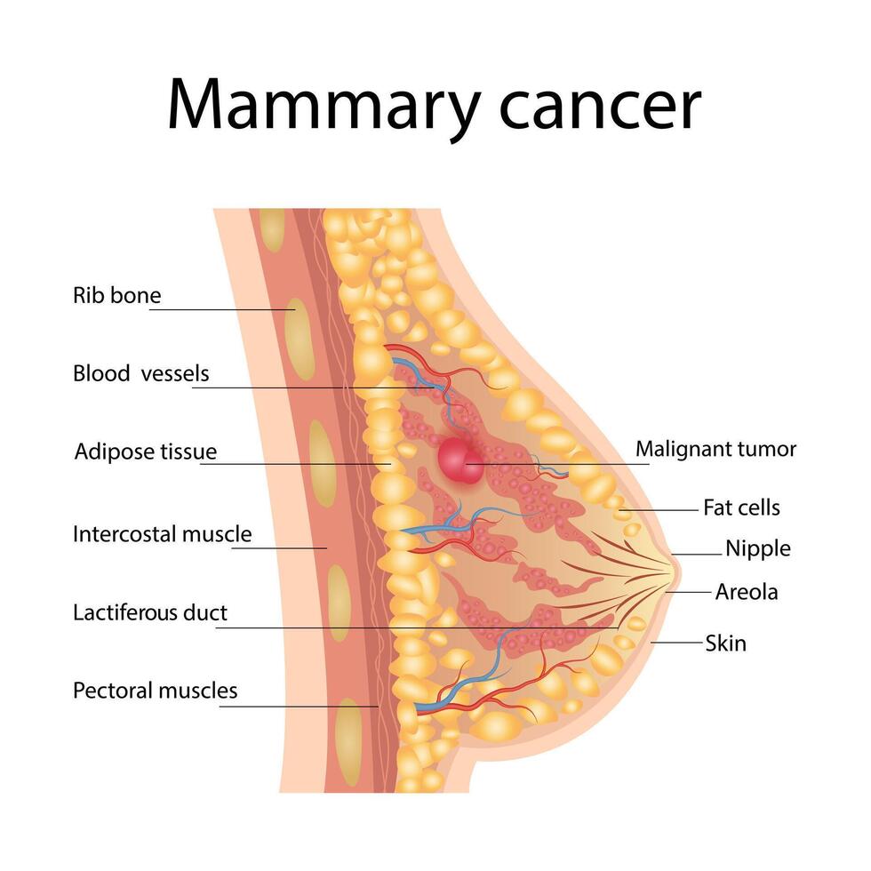Breast Cancer Medical Diagram With A Cross Section Of Female Breast
