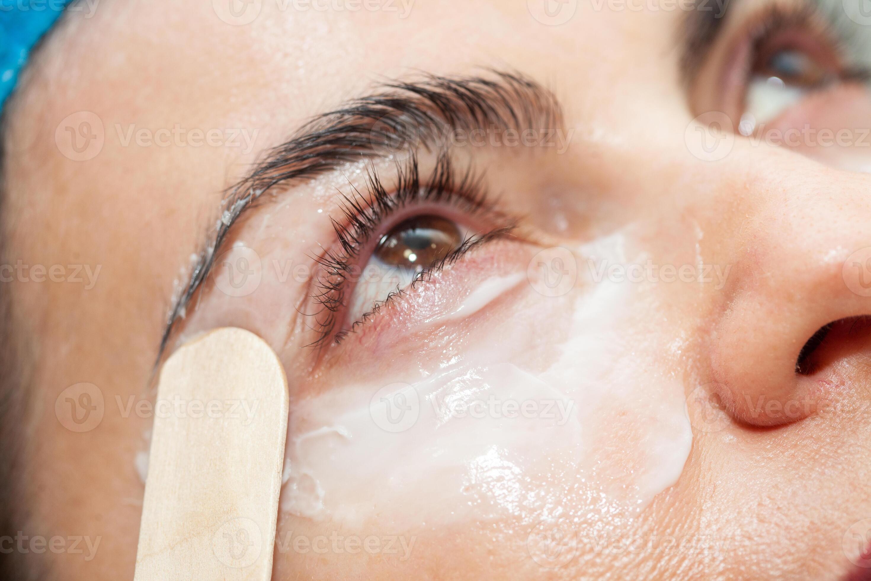 Application of topical anesthesia cream prior to a dermatological ... Application of topical anesthesia cream prior to a dermatological ...
