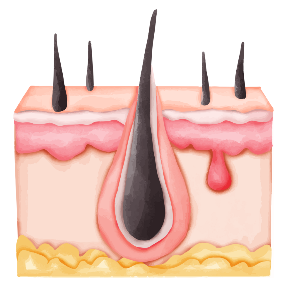 Watercolor Illustration Of An Inflamed Hair Follicle With Sebaceous Cyst 48871066 Png
