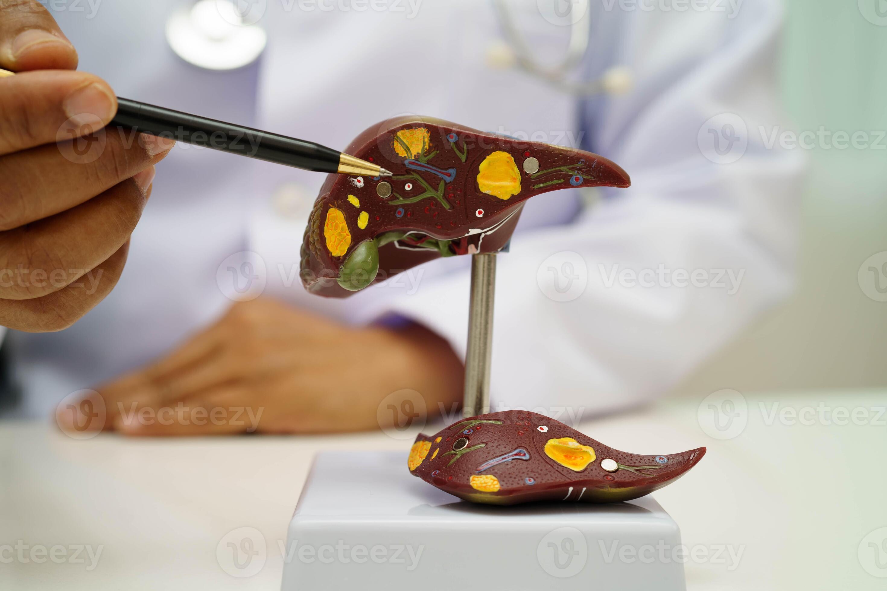 Cirrhosis, Liver cancer, fatty liver, Asian doctor with liver human ... Cirrhosis, Liver cancer, fatty liver, Asian doctor with liver human ...