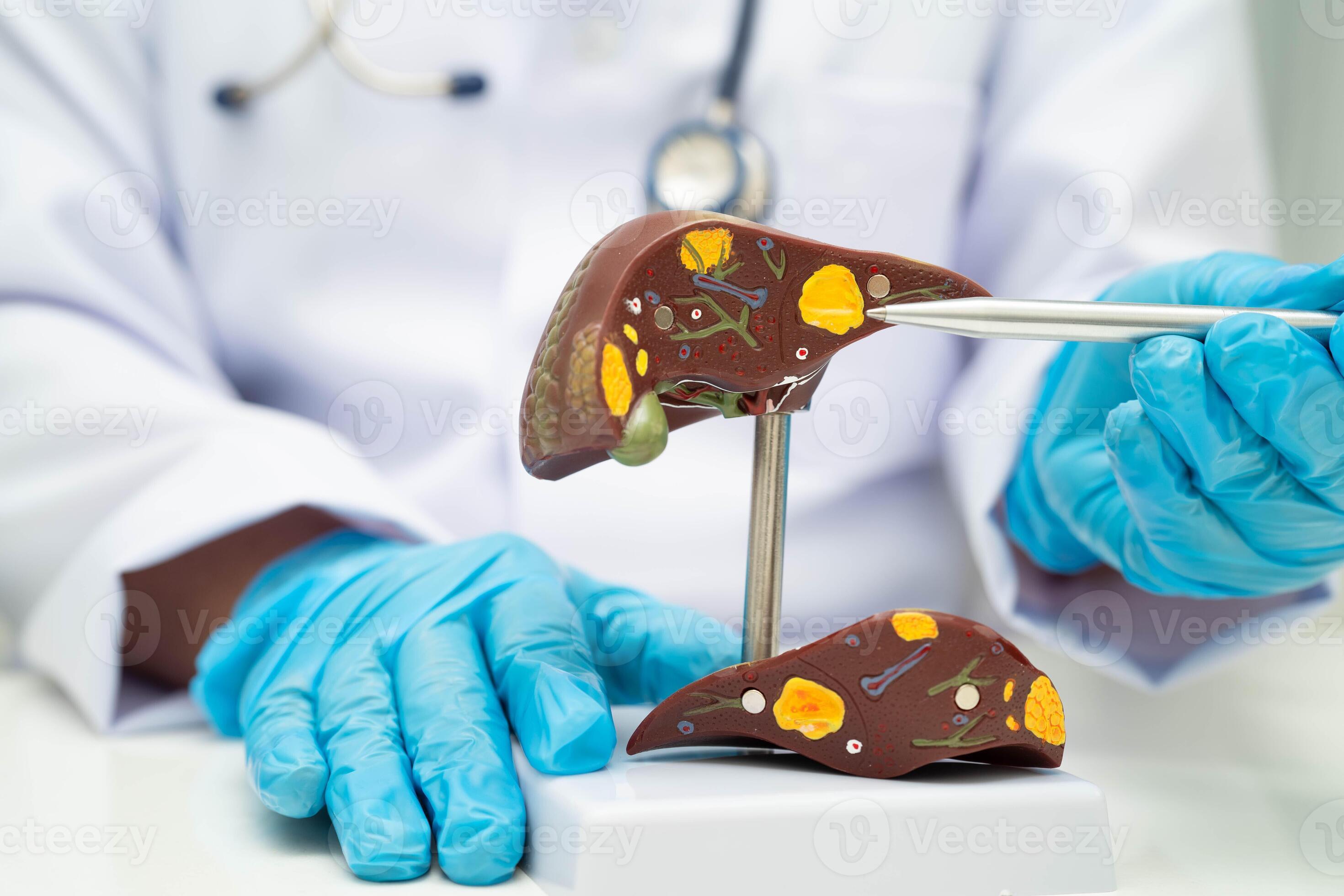 Cirrhosis, Liver cancer, fatty liver, Asian doctor with liver human ... Cirrhosis, Liver cancer, fatty liver, Asian doctor with liver human ...