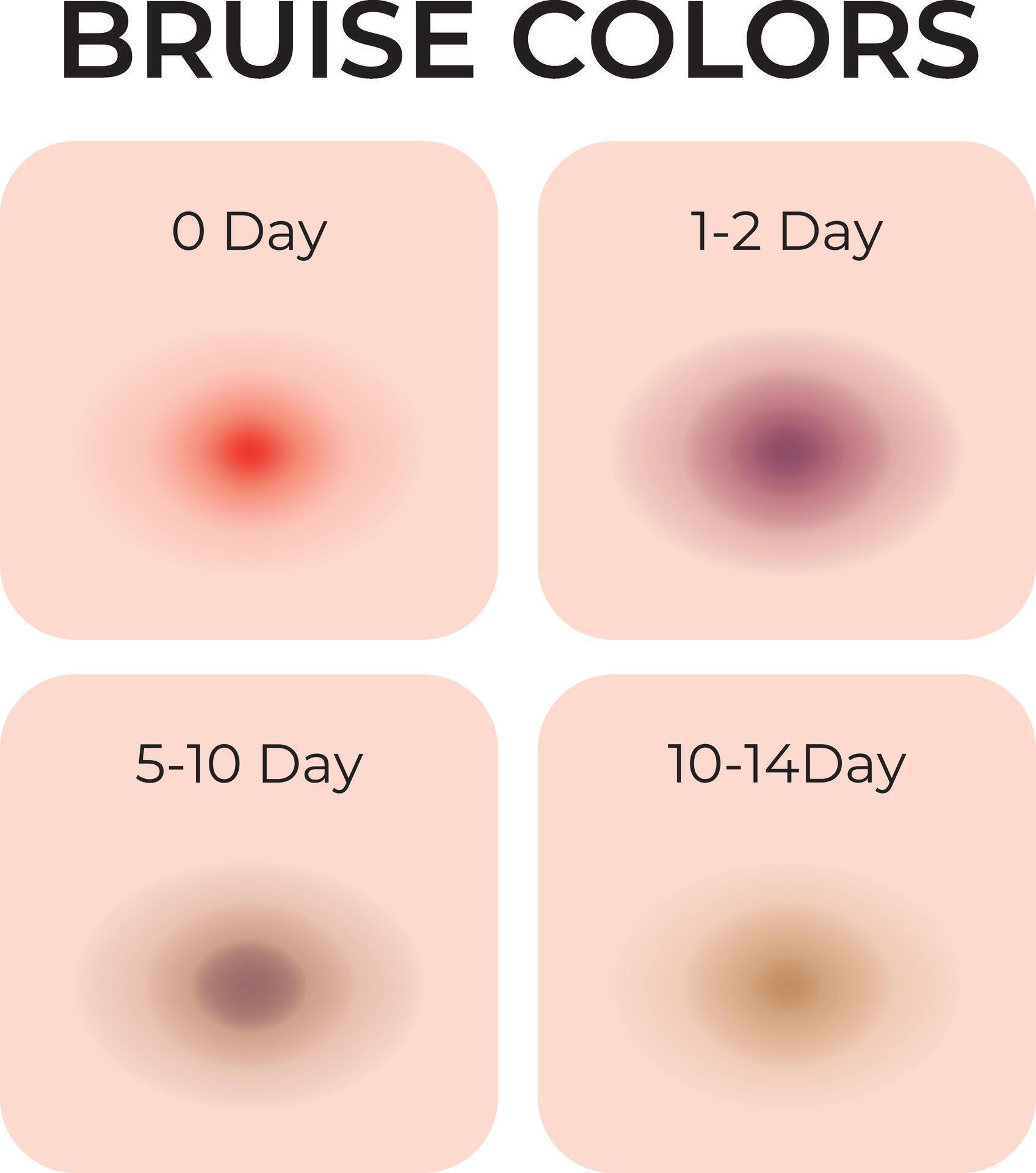 Bruise Colors Science Design Illustration Diagram 51729519 Vector Art at Vecteezy