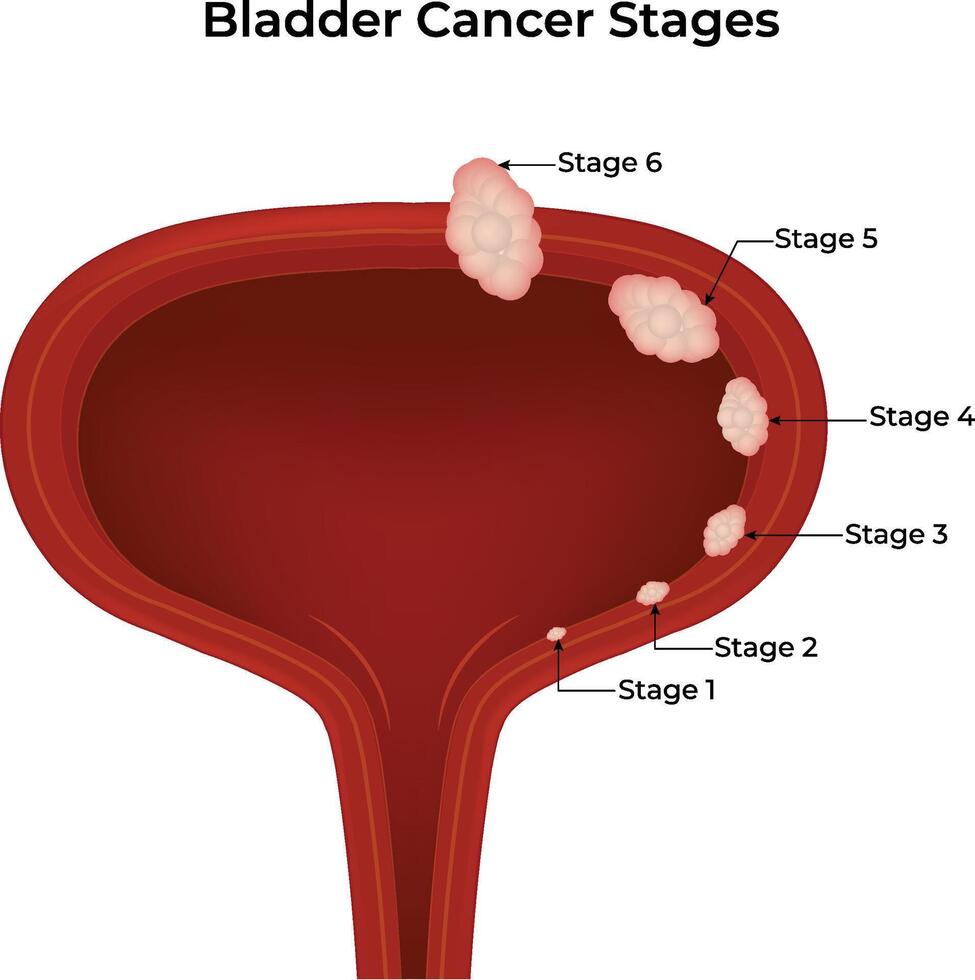 Bladder Cancer Stages Illustration 54061236 Vector Art At Vecteezy