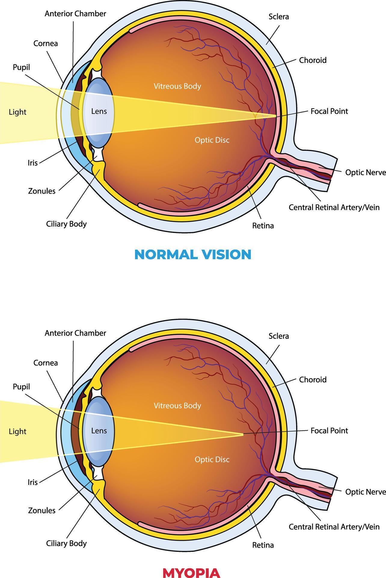 illustration of Myopia vs normal eye diagram 54068166 Vector Art at Vecteezy