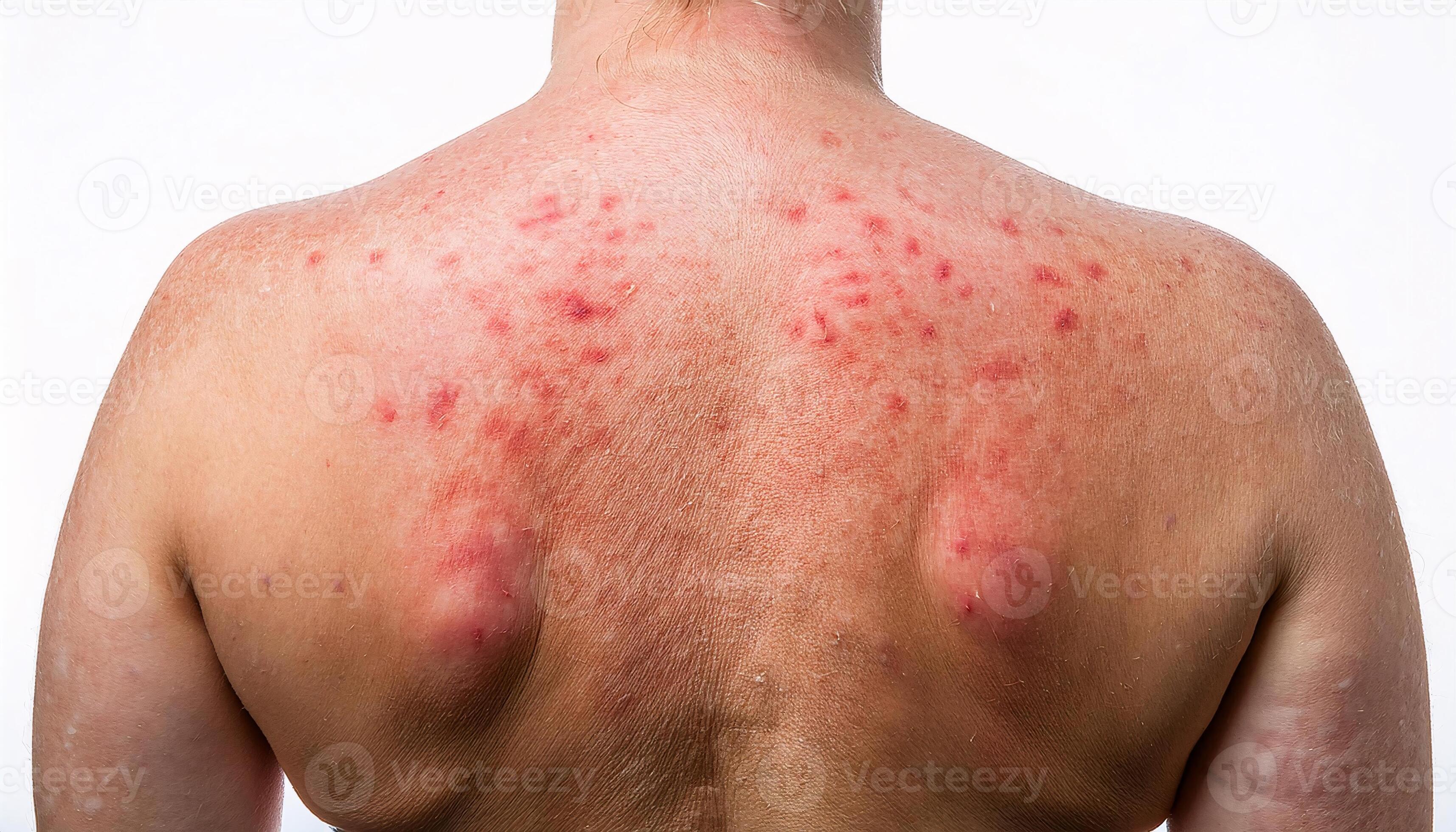close-up of severe heat rash on the back with inflamed red bumps and irritation for dermatology ...