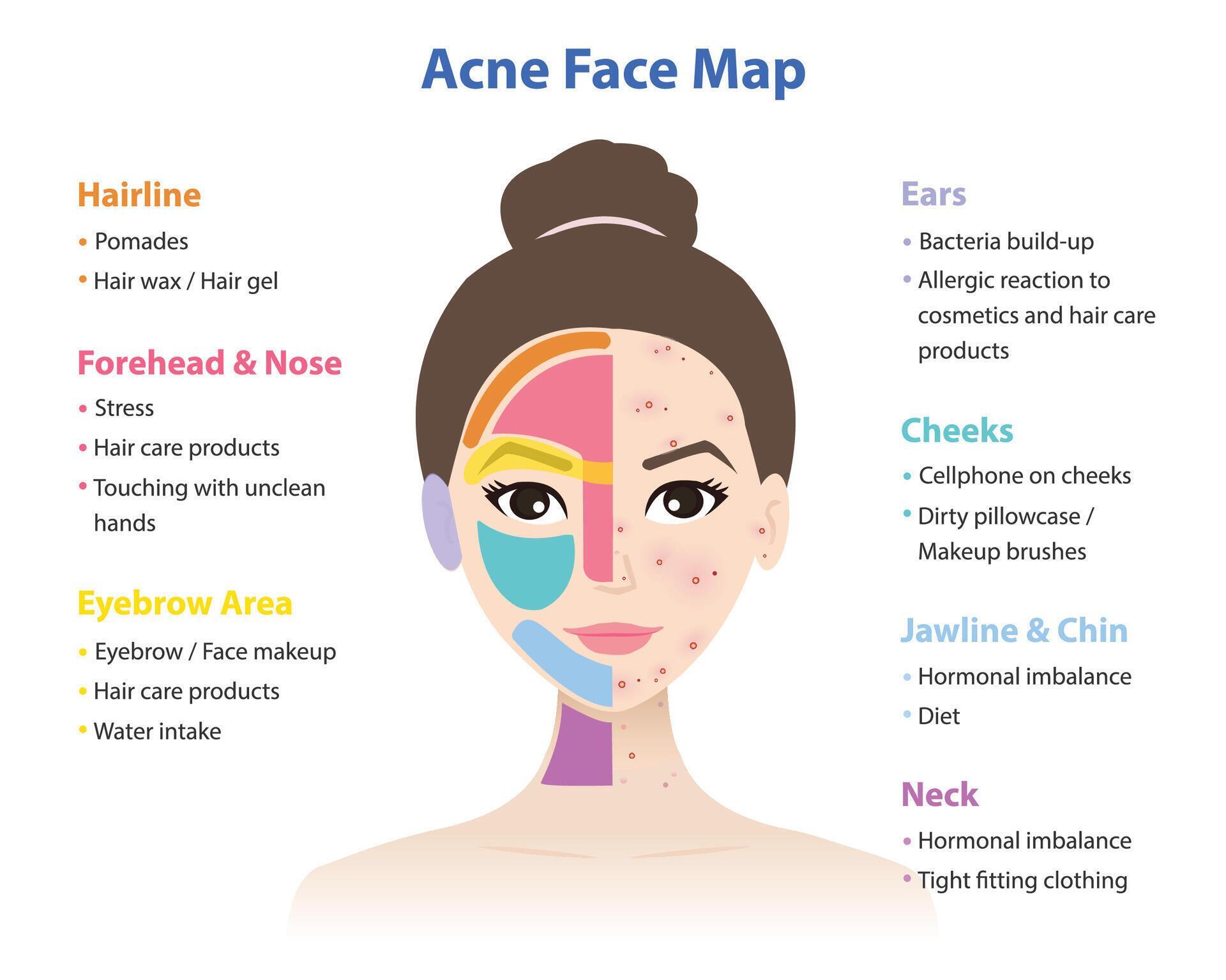 Acne face map on woman face illustration isolated on white background. Diagram of acne causes on ...